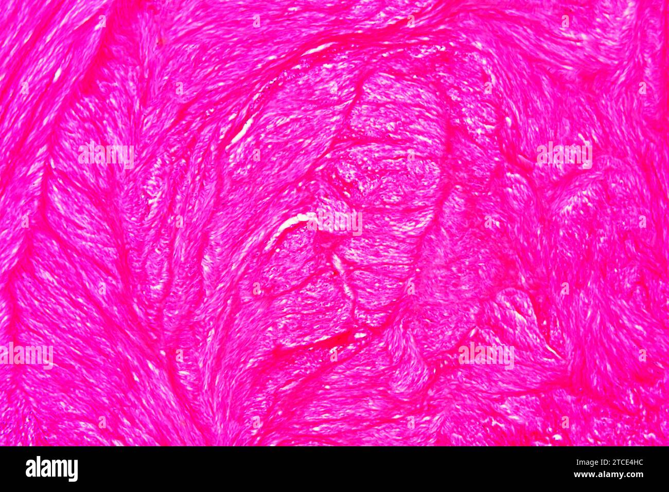 Human uterine fibroid (benign tumor). Optical microscope X100 Stock ...