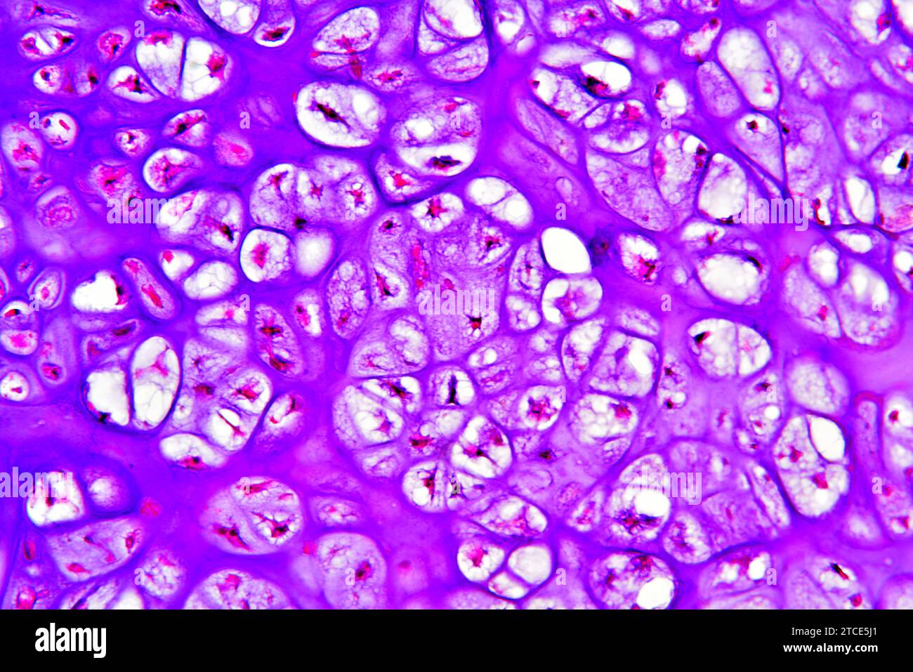 Human pubic bone chondrosoma (benign tumor) showing chondrocytes and ...