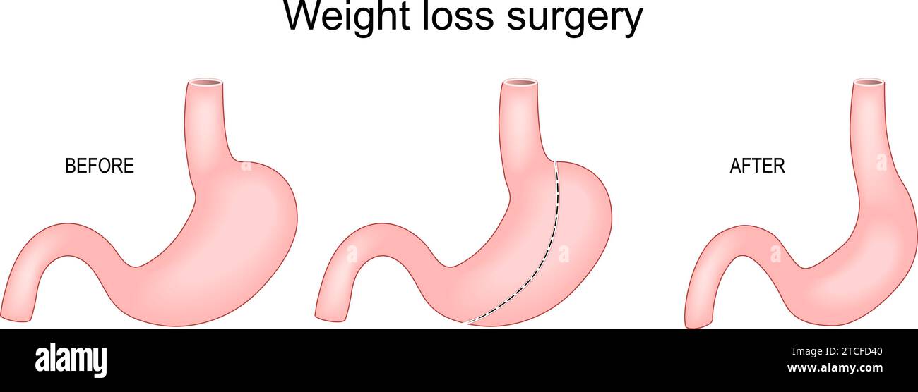 Horizontal Gastroplasty