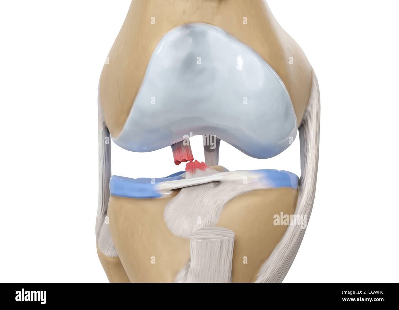 Illustration of a tear of the anterior cruciate ligament in an front ...