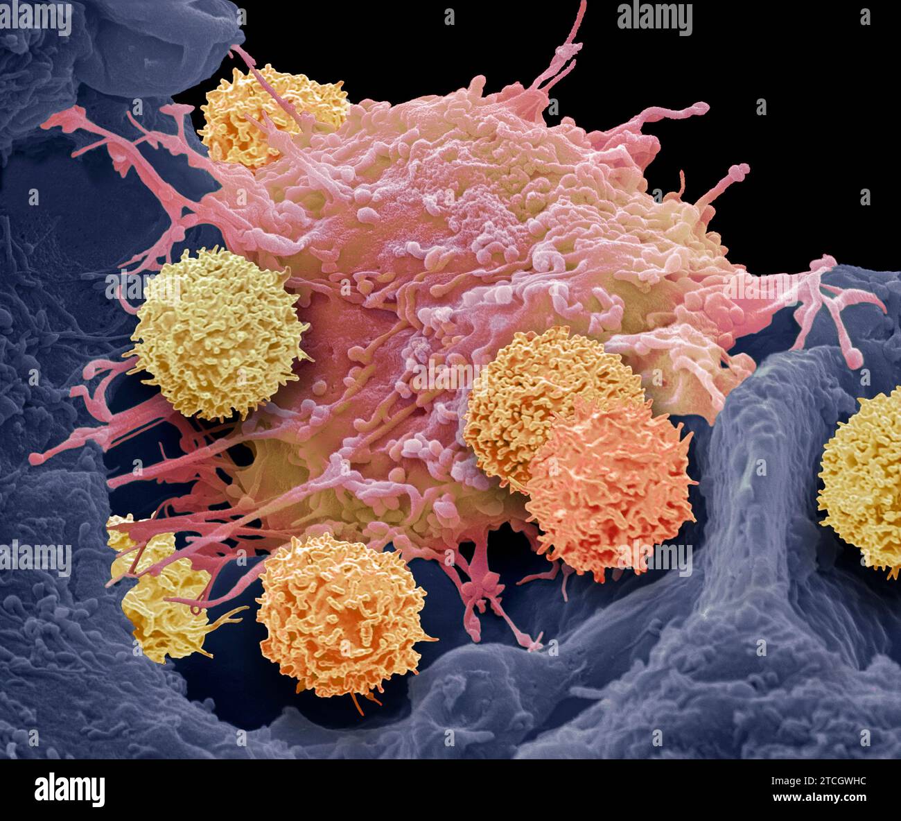 (CAR) T-cell therapy. Composite coloured scanning electron micrograph ...