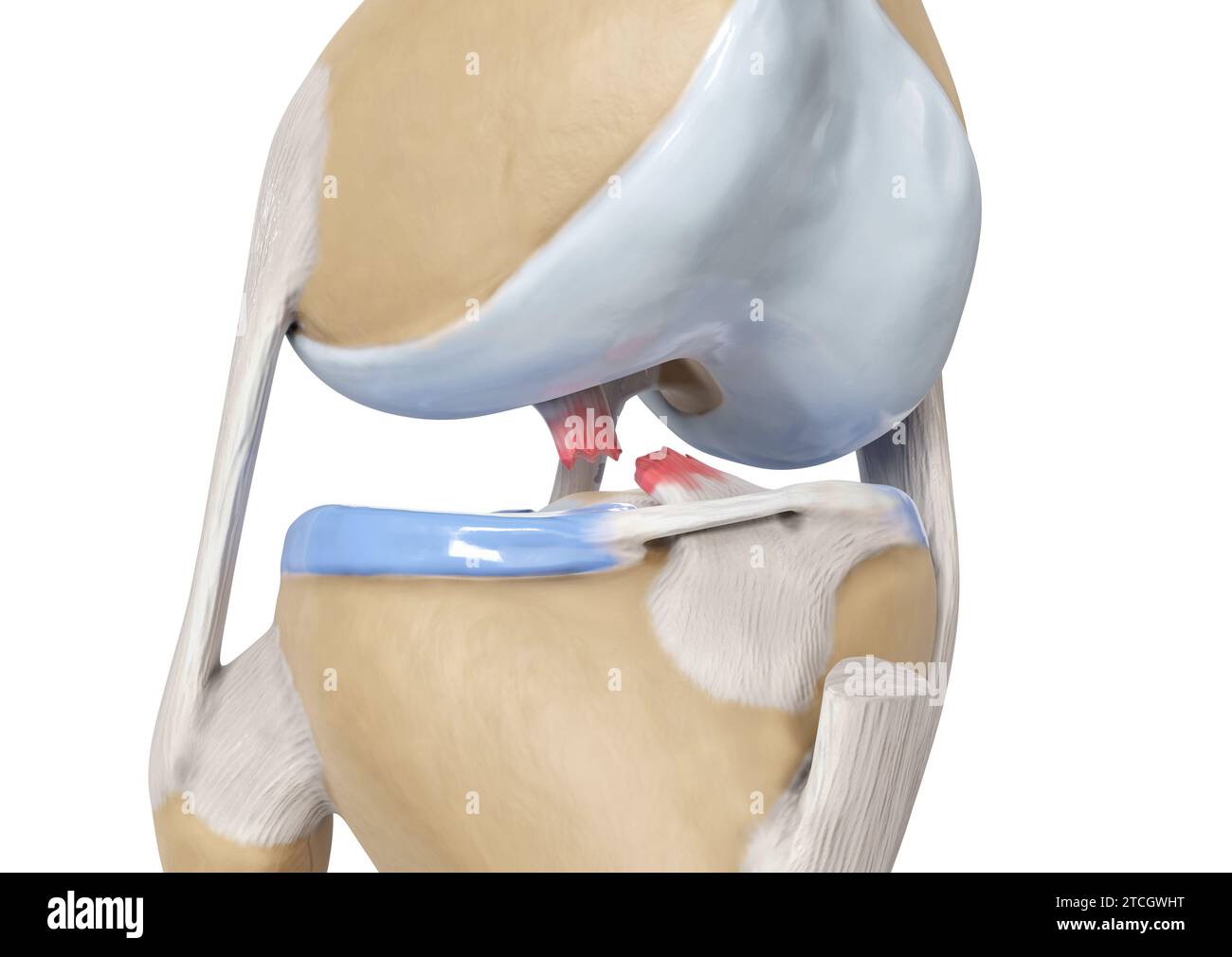 Illustration of a tear of the anterior cruciate ligament in an lateral ...