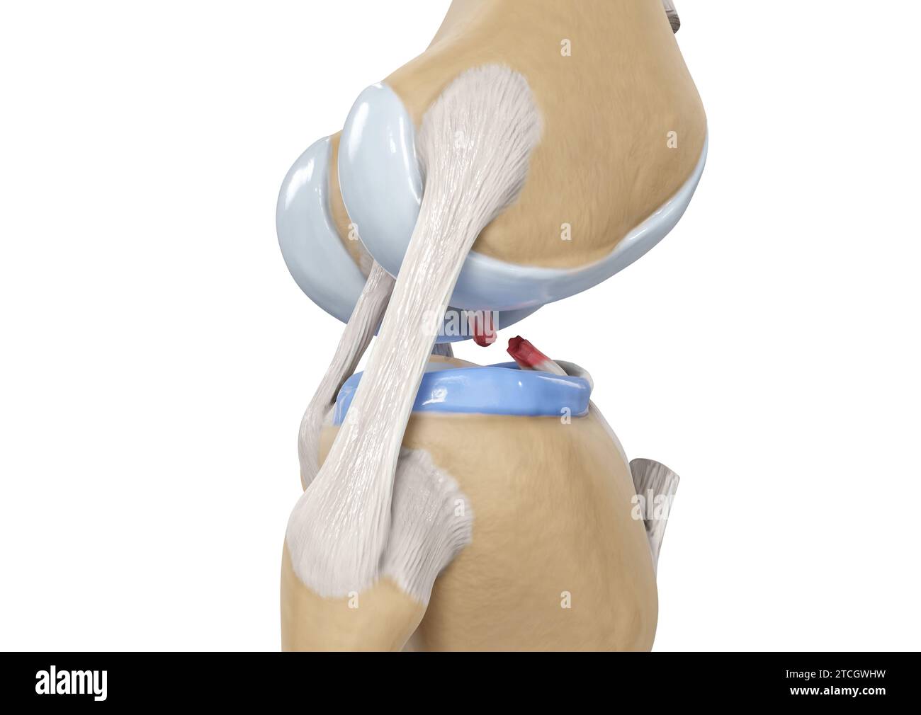 Illustration of a tear of the anterior cruciate ligament in an lateral ...