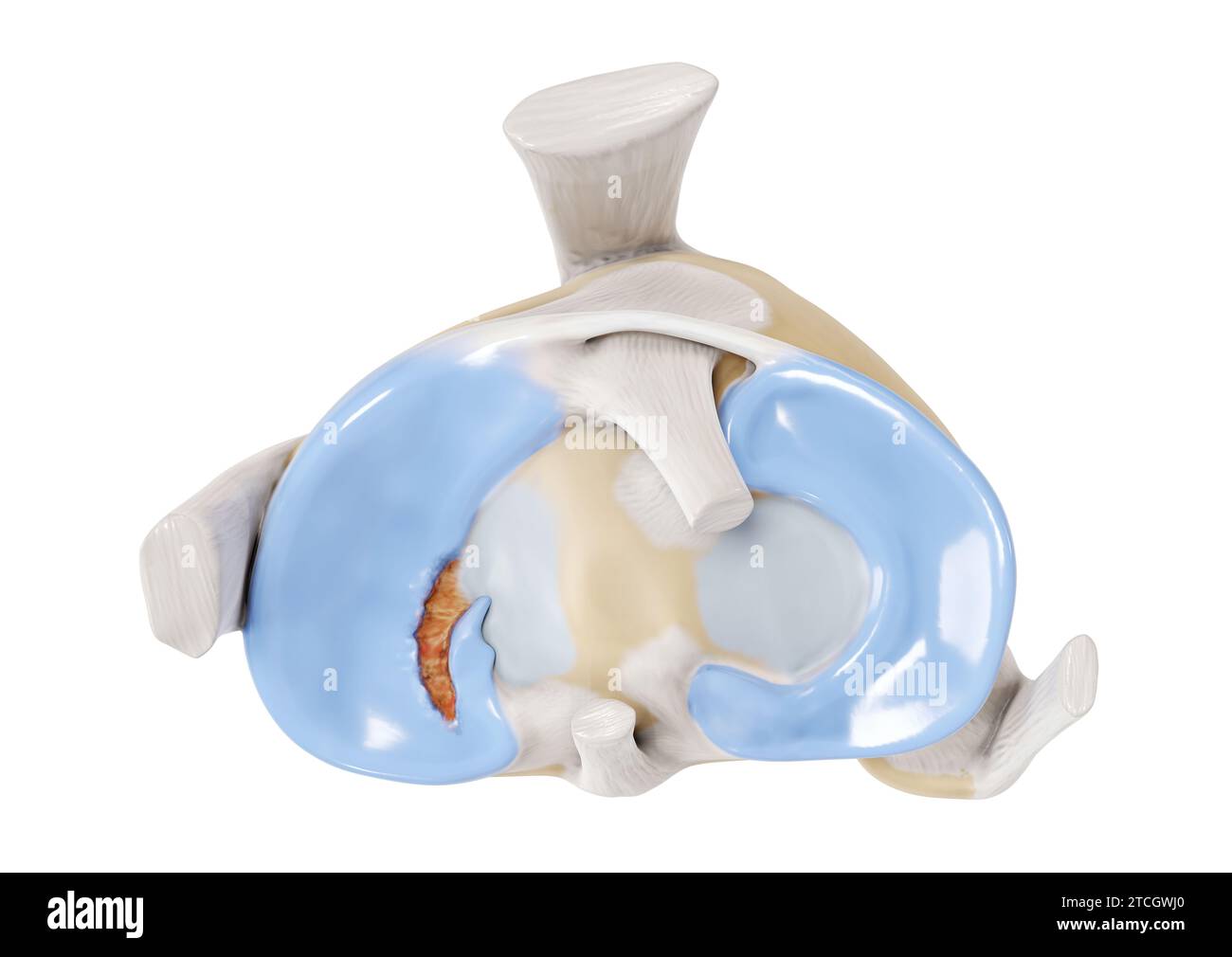 Illustration of a flap tear (oblique tear) in the medial meniscus on a ...