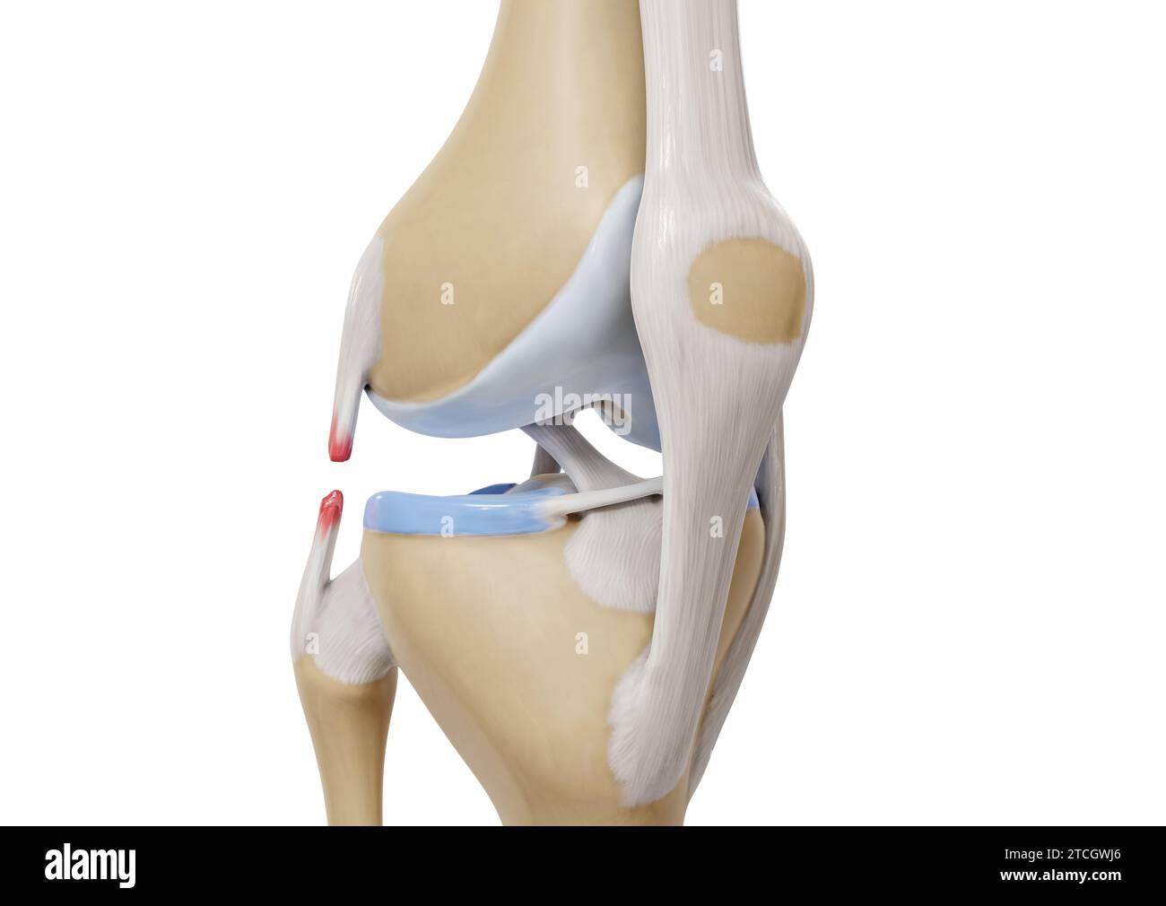 Illustration of a tear of the lateral collateral ligament (fibular ...