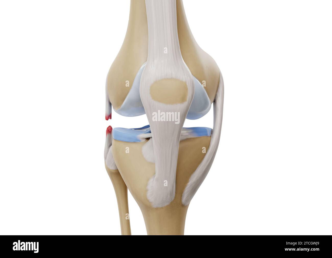 Illustration of a tear of the lateral collateral ligament (fibular ...