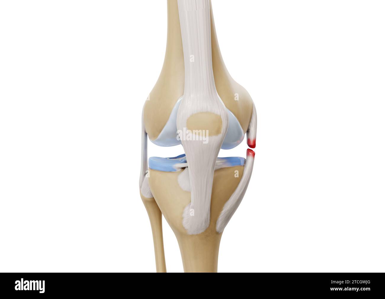 Illustration of a tear of the medial collateral ligament (tibial ...