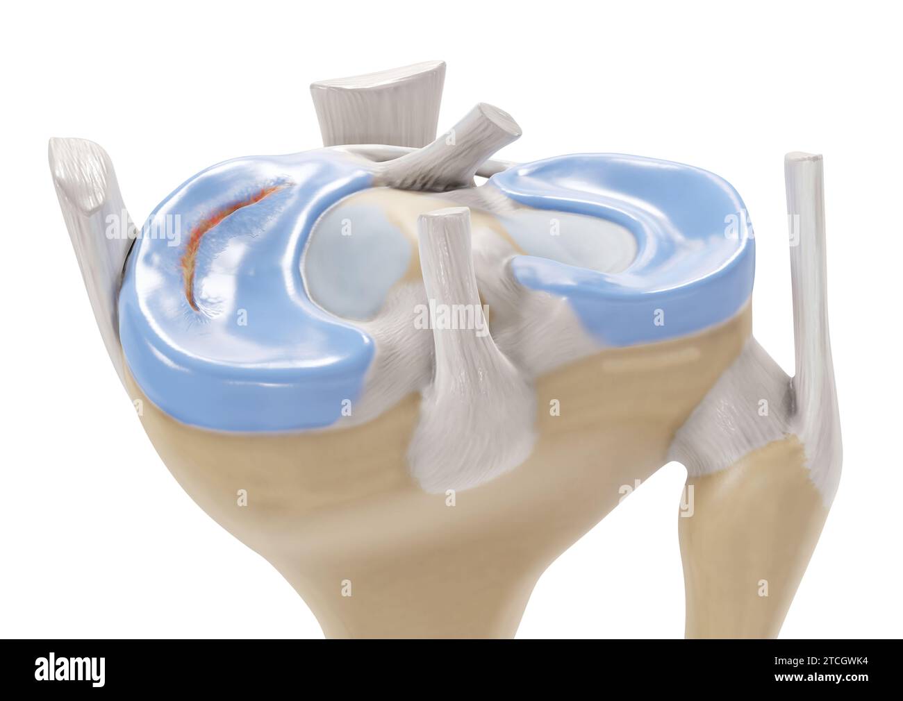 Illustration of a longitudinal tear in the medial meniscus of a right ...
