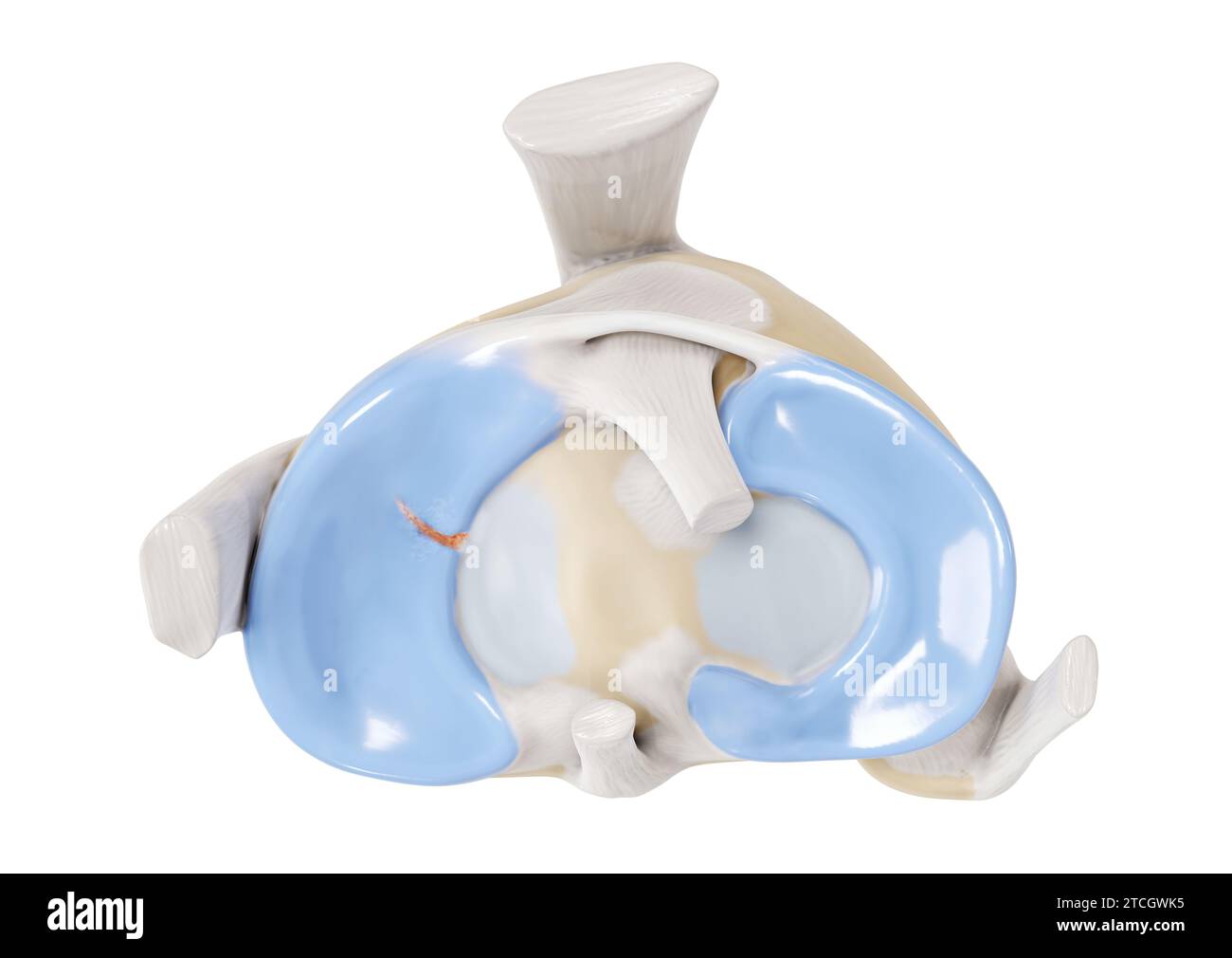 Illustration of a radial (transverse) tear in the medial part (pars ...