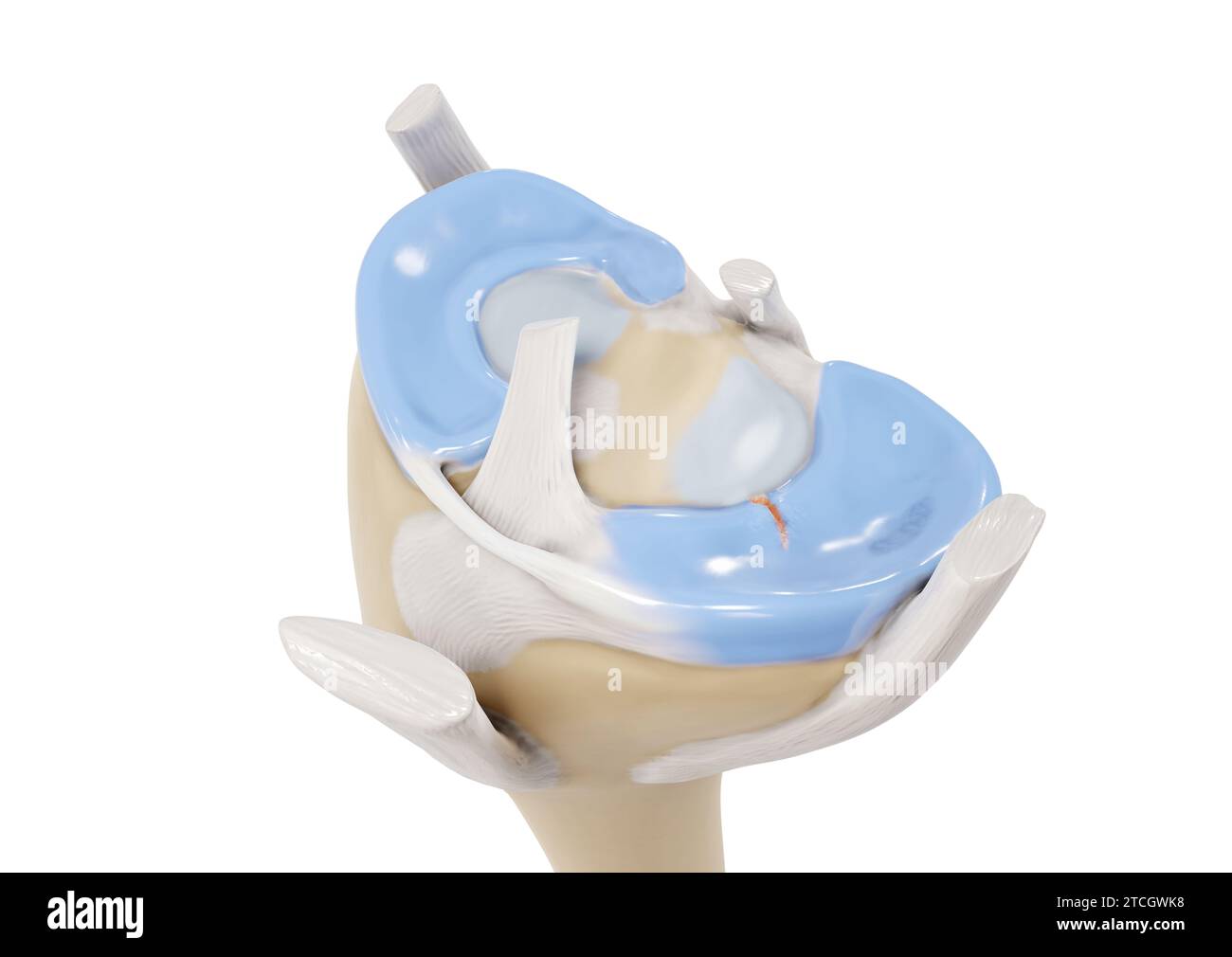 Illustration of a radial (transverse) tear in the medial part (pars ...