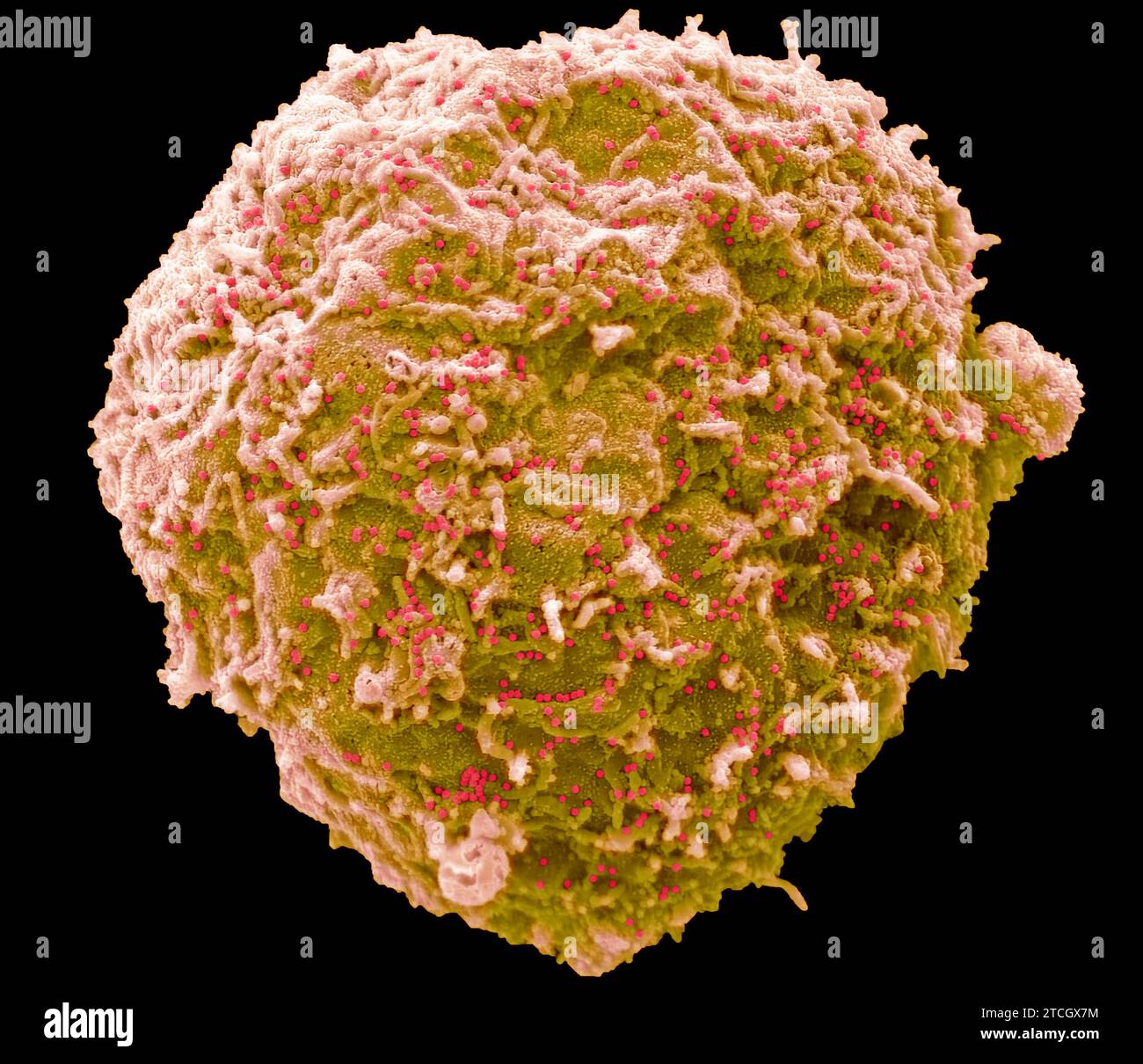 Human adenovirus strain J.J. subtype D/10 (HAdV-10). Scanning electron ...