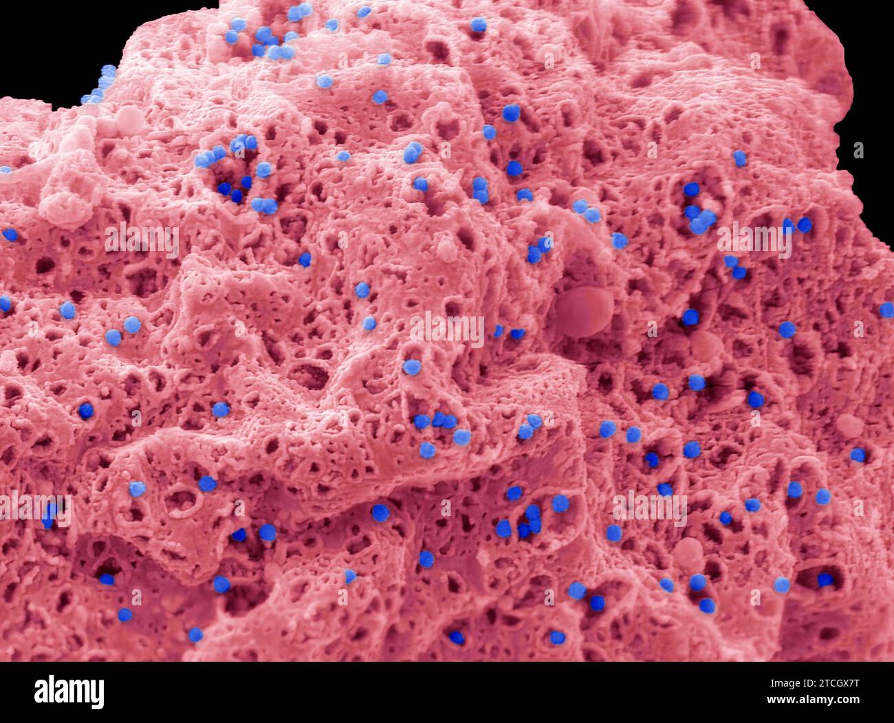Human adenovirus strain J.J. subtype D/10 (HAdV-10). Scanning electron ...