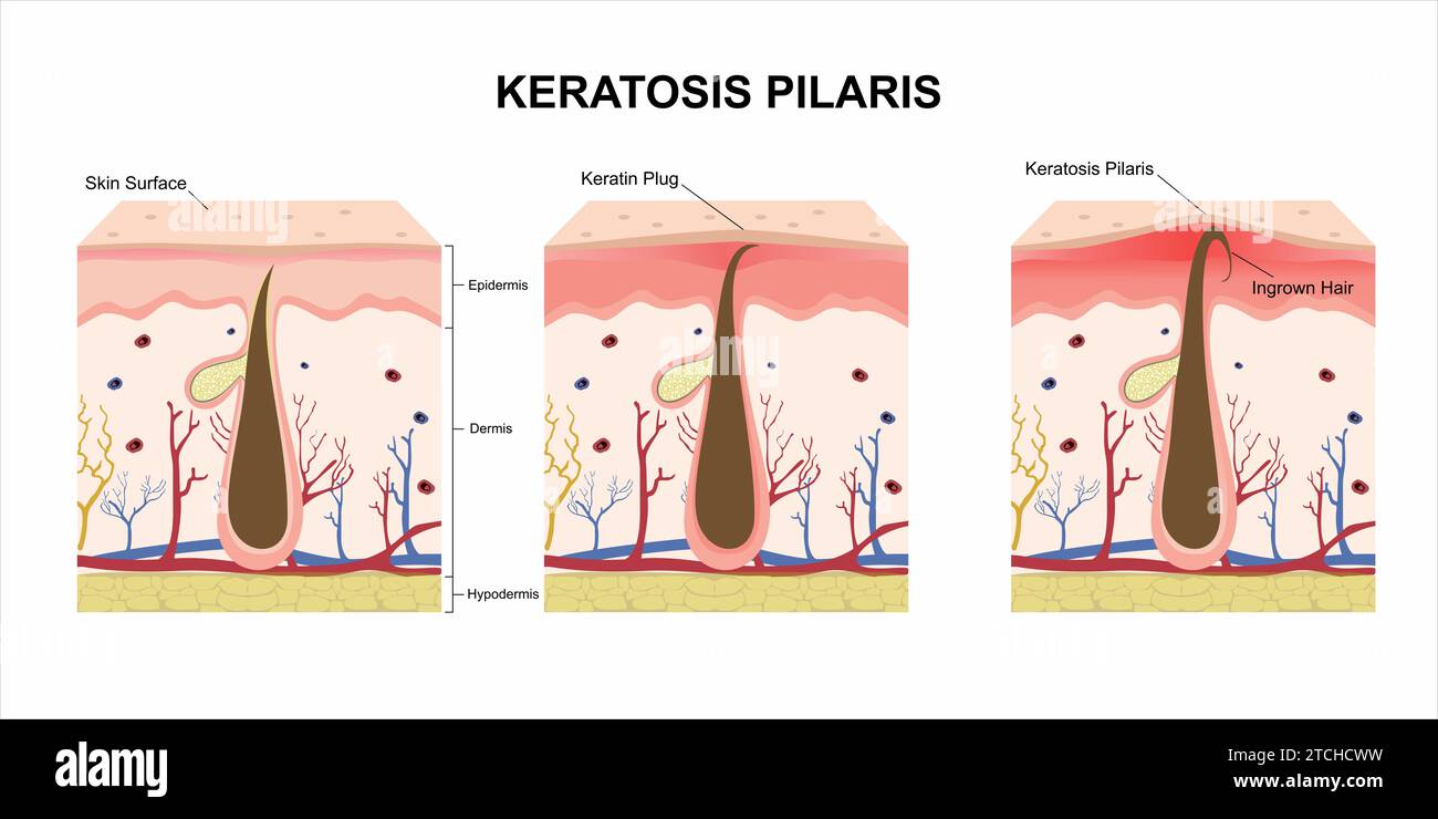 Keratosis Pilaris Illustration Keratosis Pilaris Treatment