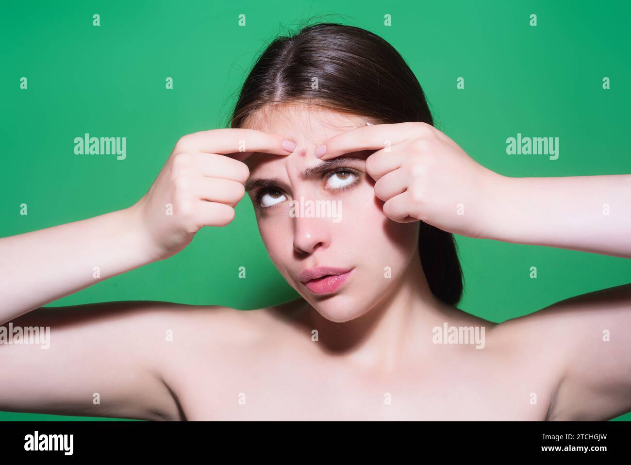 Young Woman with Pustule Acne Squeeze out Pimples. Acne on the skin ...