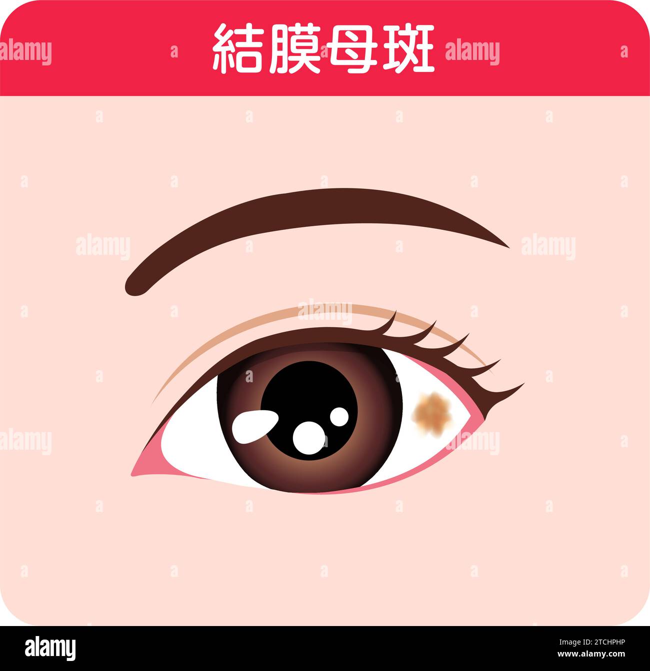 Conjunctival nevus vector illustration Stock Vector Image & Art - Alamy