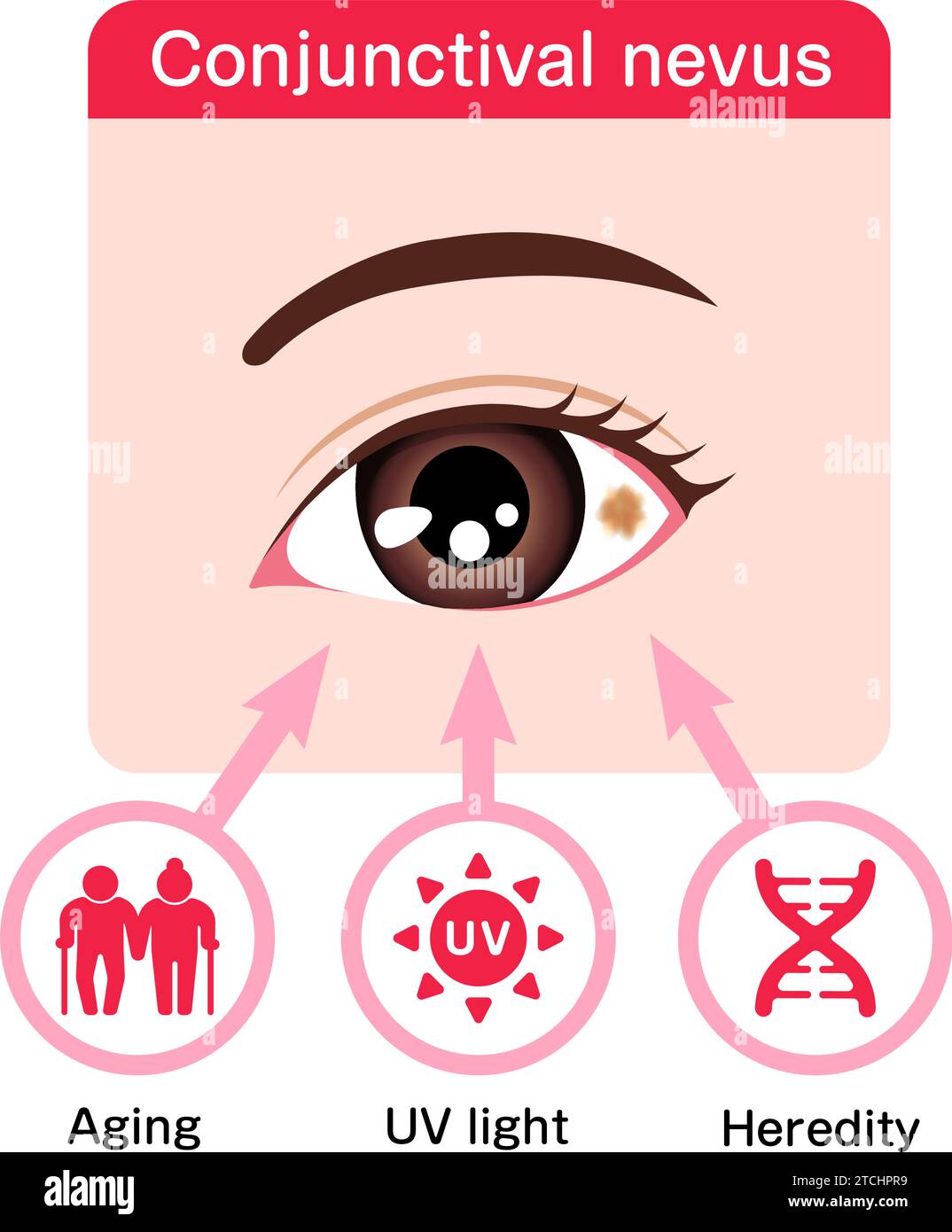 Causes of Conjunctival nevus vector illustration Stock Vector Image ...