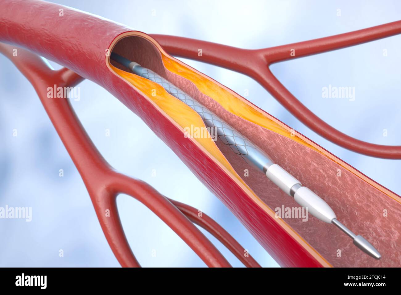 Coronary angioplasty with stenting (percutaneous coronary intervention ...