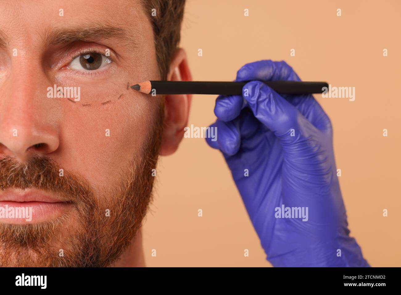 Doctor drawing marks on man's face for cosmetic surgery operation ...