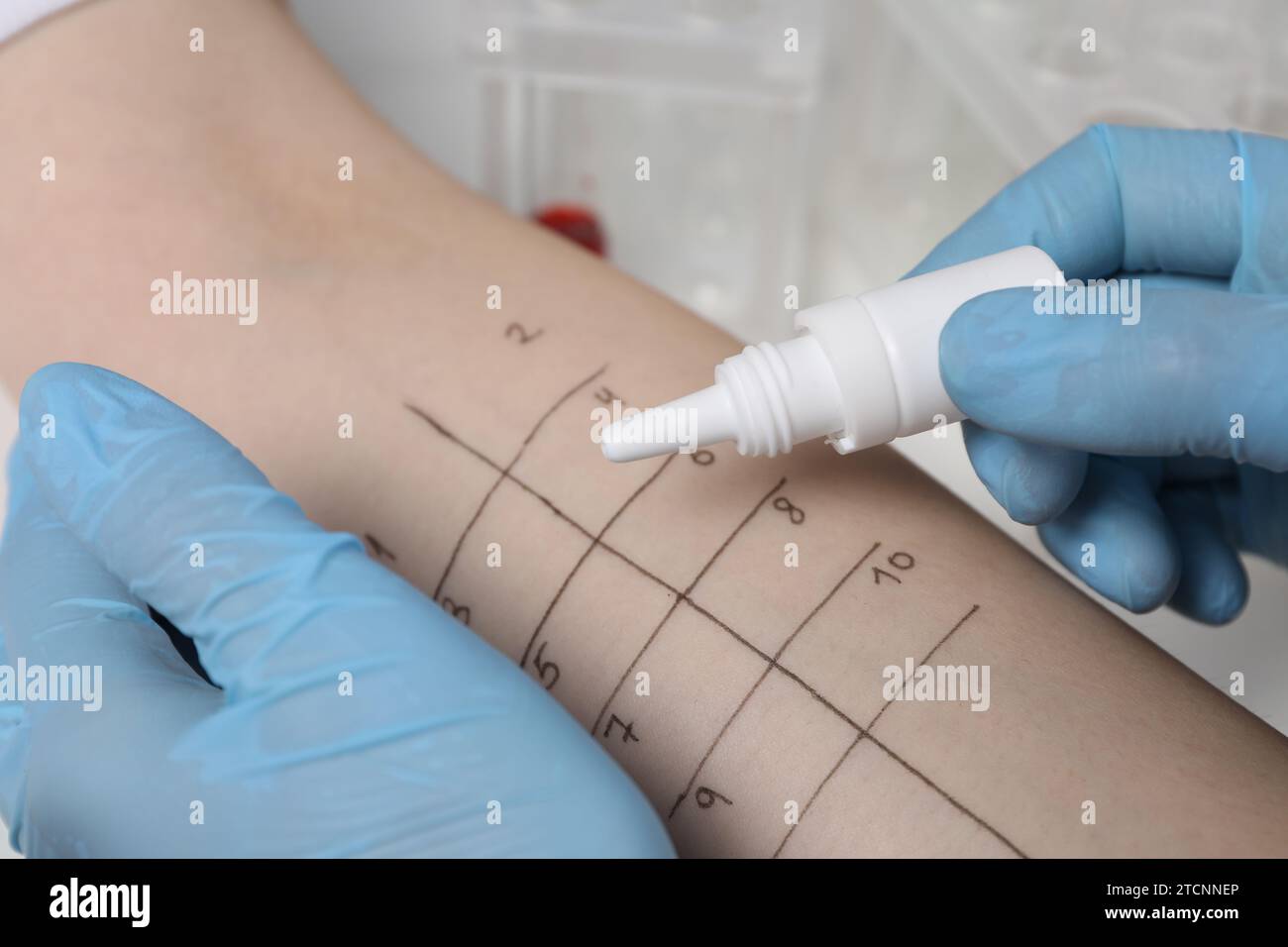 Doctor doing skin allergy test at light table, closeup Stock Photo - Alamy