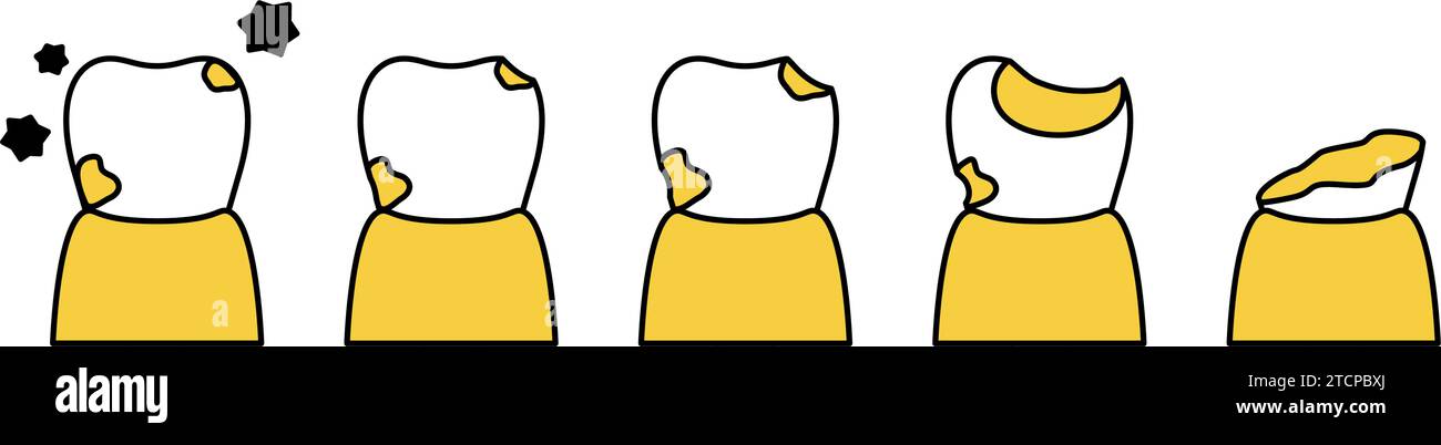 Illustration of image of cavity progression, simple line drawing ...
