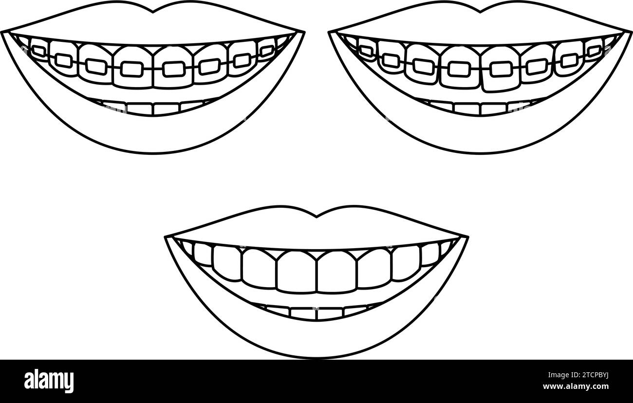 Teeth with metal brackets in cosmetic dentistry and orthodontics ...
