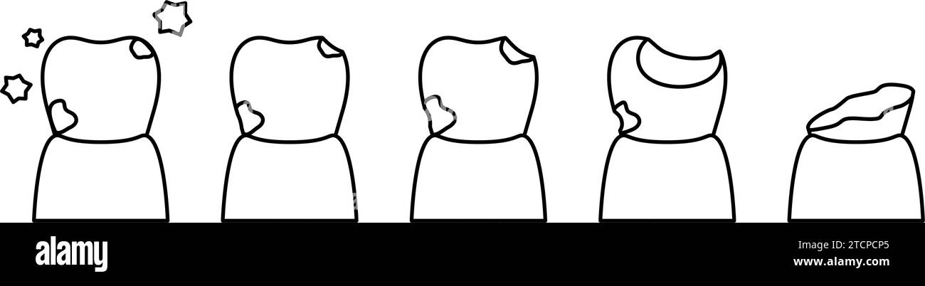 Illustration of image of cavity progression, simple line drawing ...