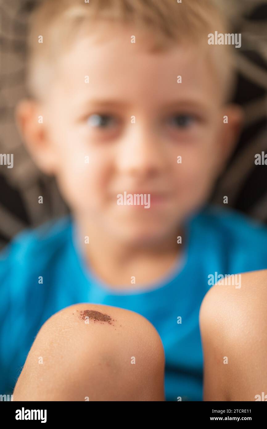 knee with the crust and boy's face in the background Stock Photo - Alamy