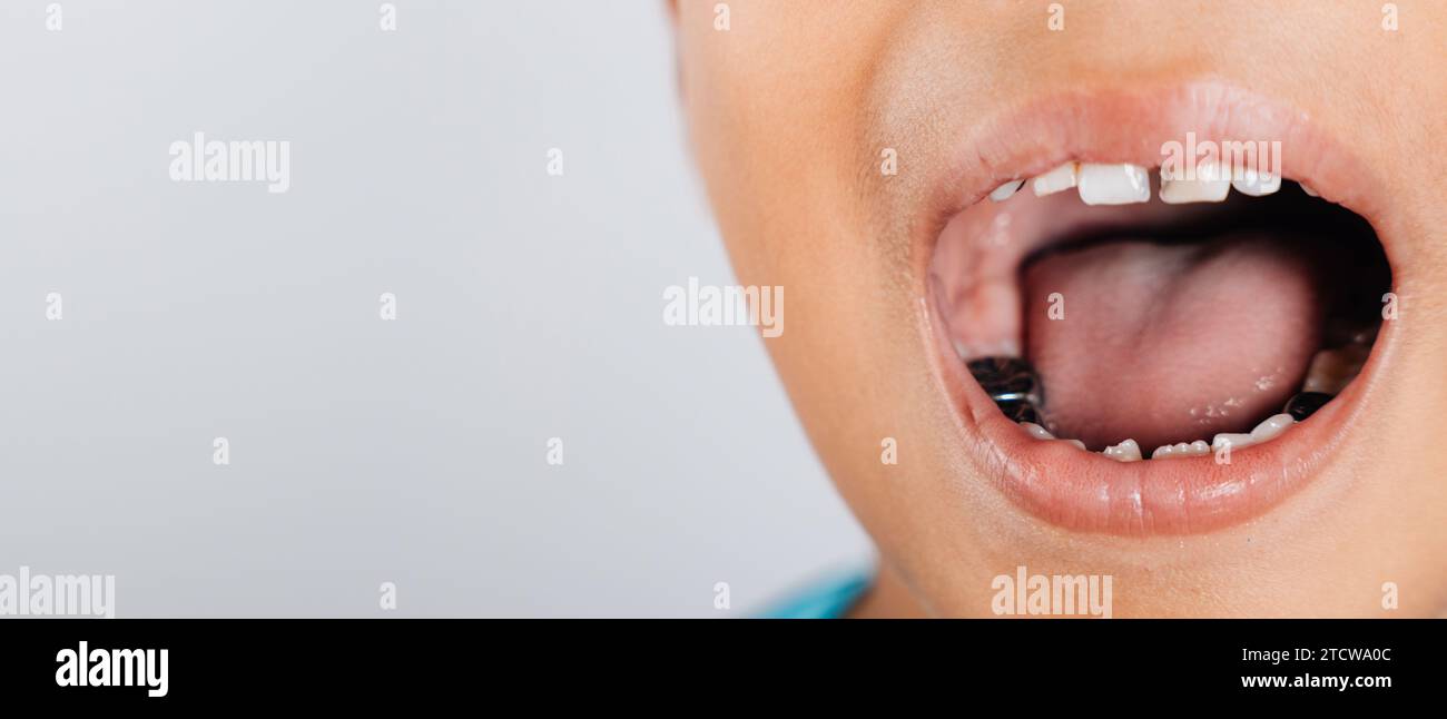 Stainless steel crown a dental treatment for restoring a child's tooth ...