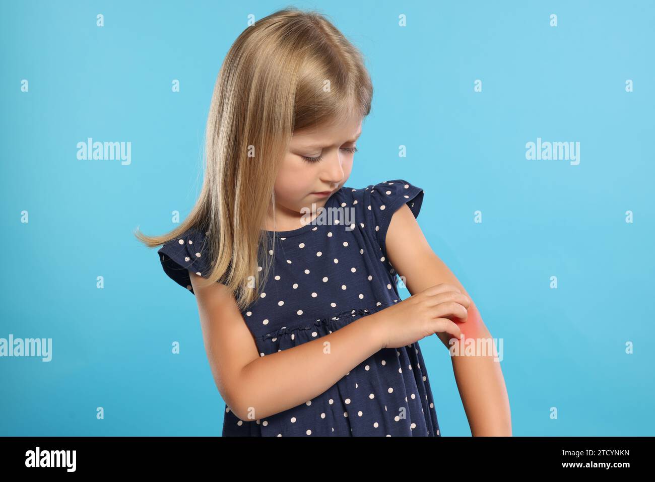 Suffering from allergy. Little girl scratching her arm on light blue ...