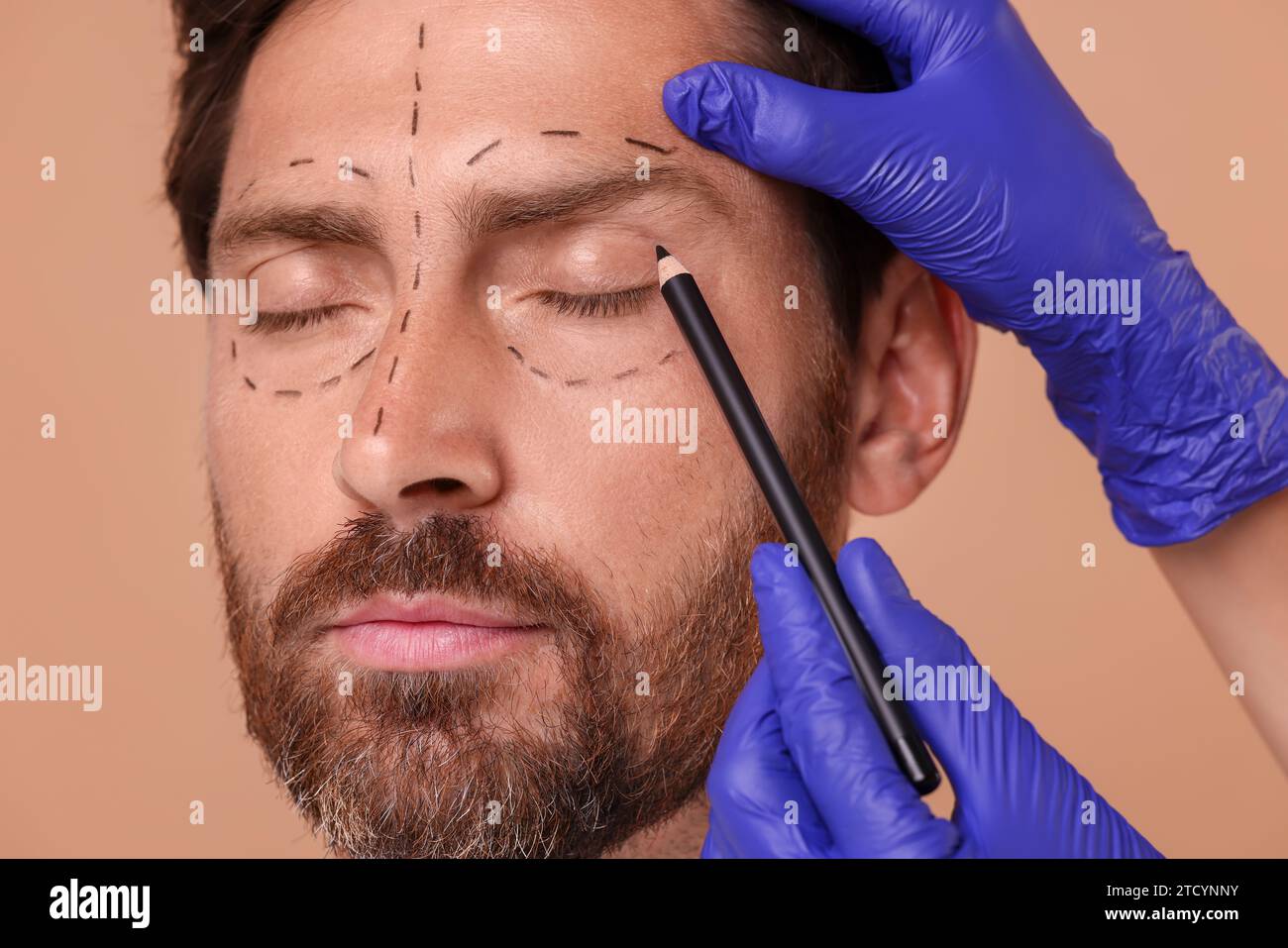 Doctor drawing marks on man's face for cosmetic surgery operation ...