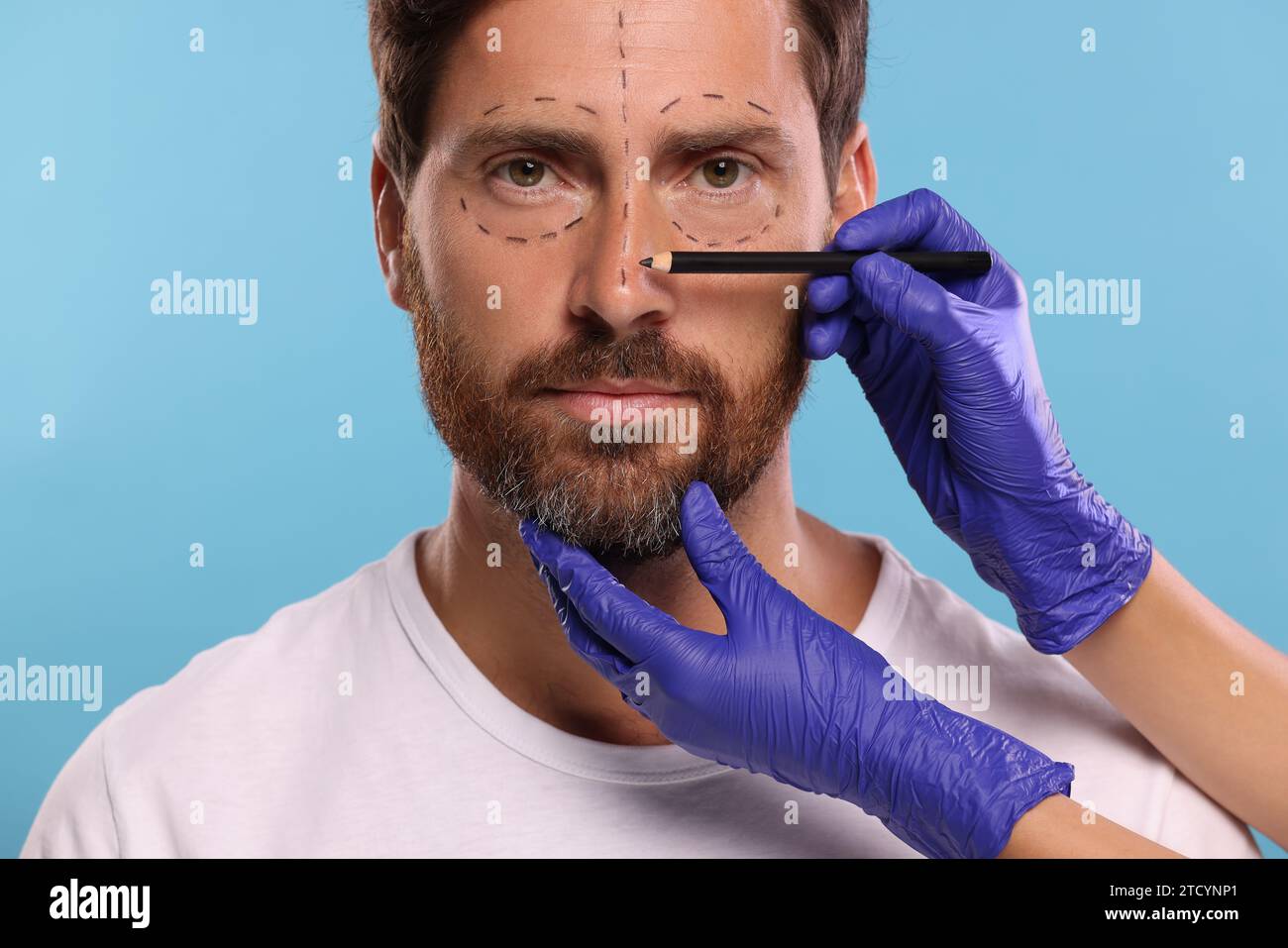 Doctor drawing marks on man's face for cosmetic surgery operation ...