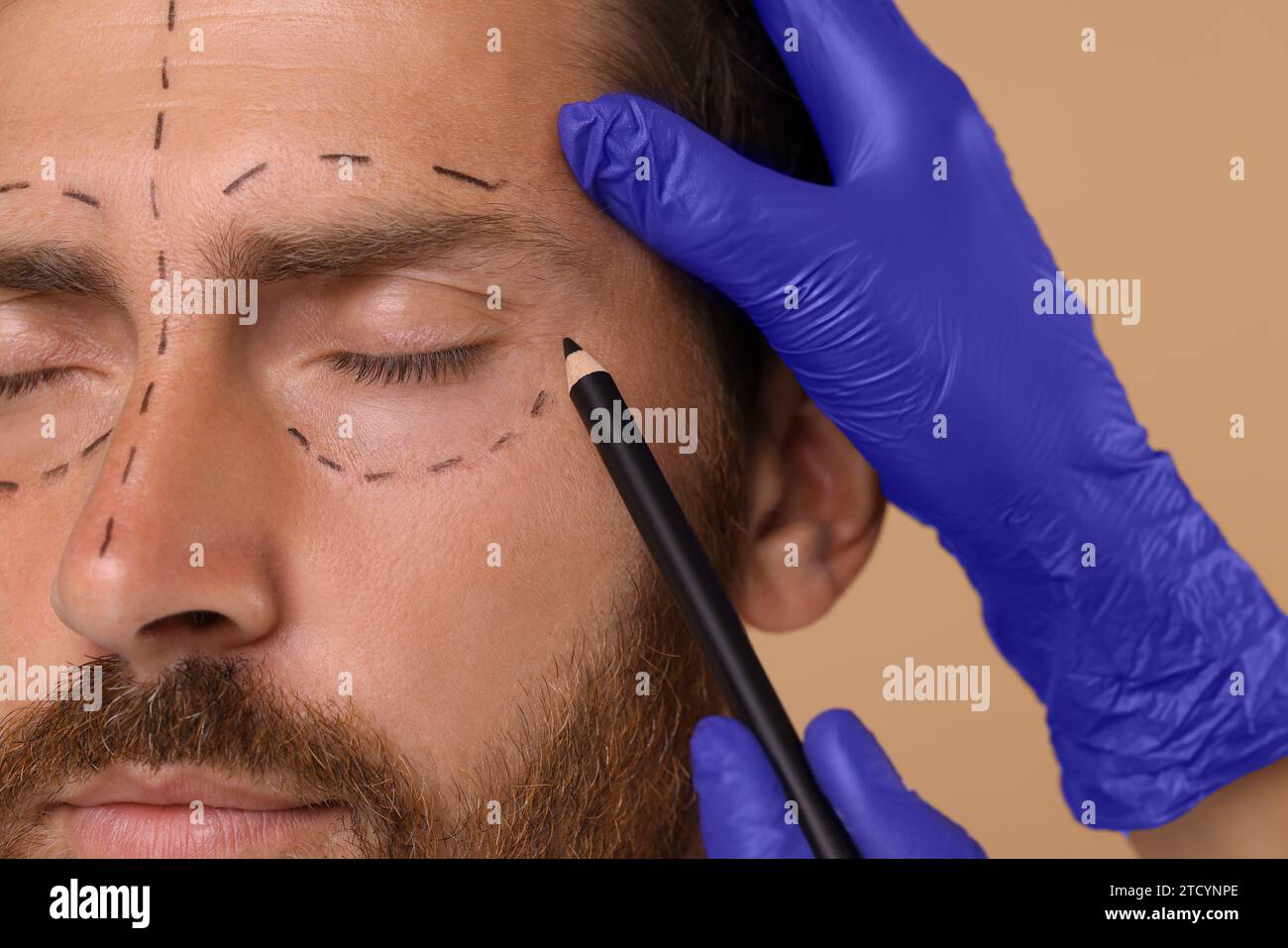 Doctor drawing marks on man's face for cosmetic surgery operation ...