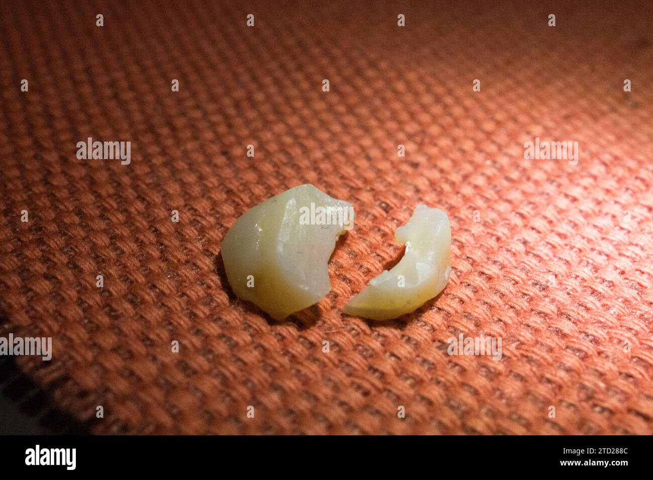 Seattle, USA. 27 Nov, 2023. A broken temporary molar crown Stock Photo ...
