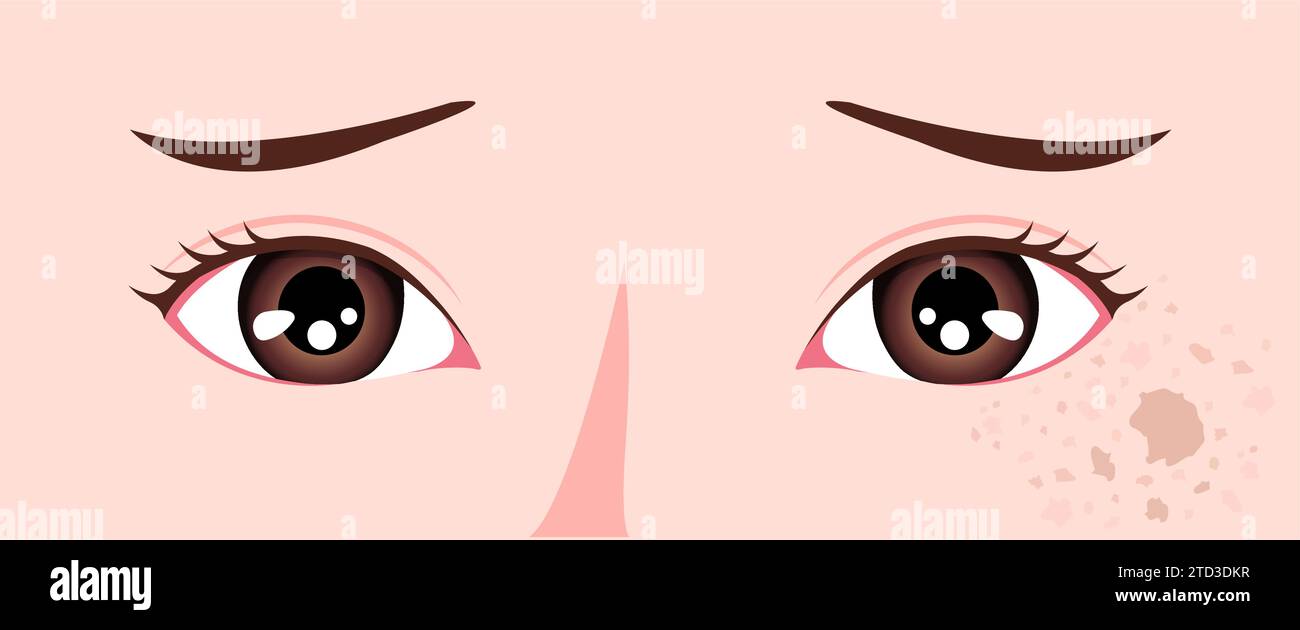 Vector illustration of normal facial skin and facial skin with spots ...