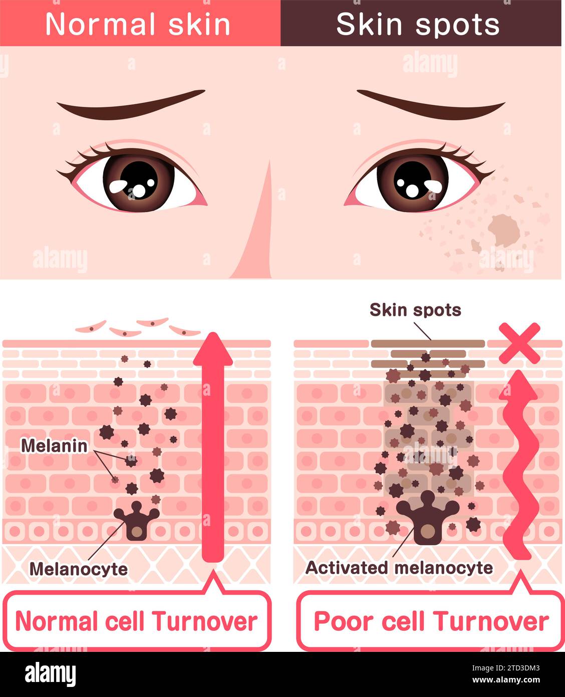 Vector illustration of how skin spots (hyperpigmentation) are created ...