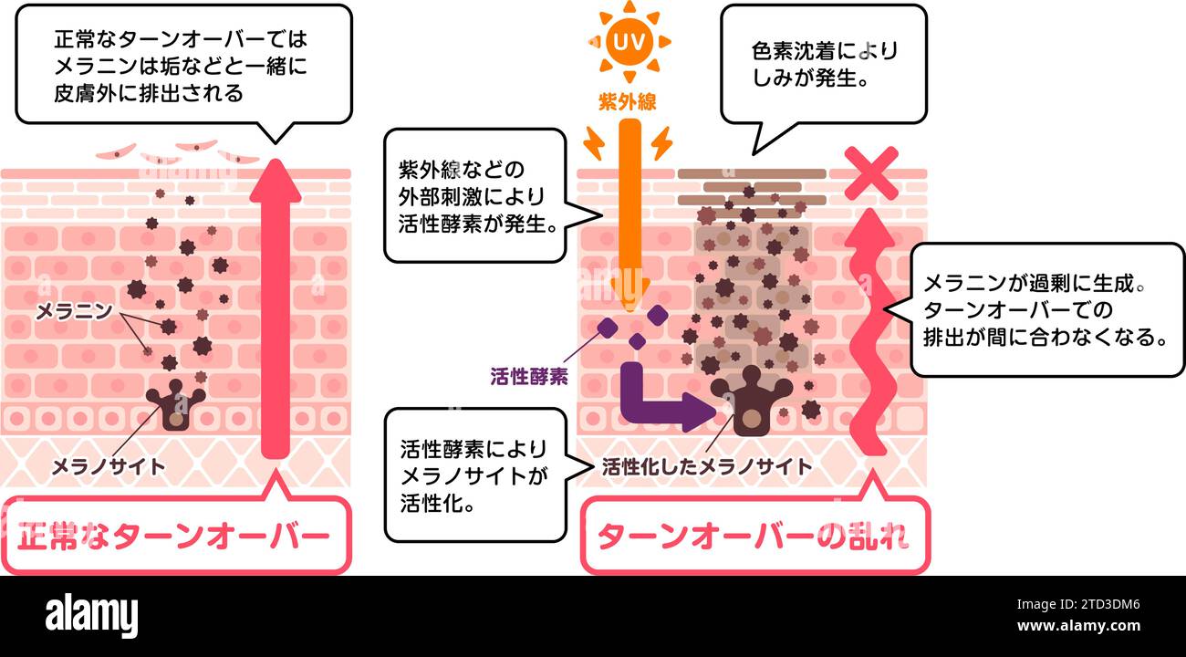 Vector illustration of how skin spots (hyperpigmentation) are created ...