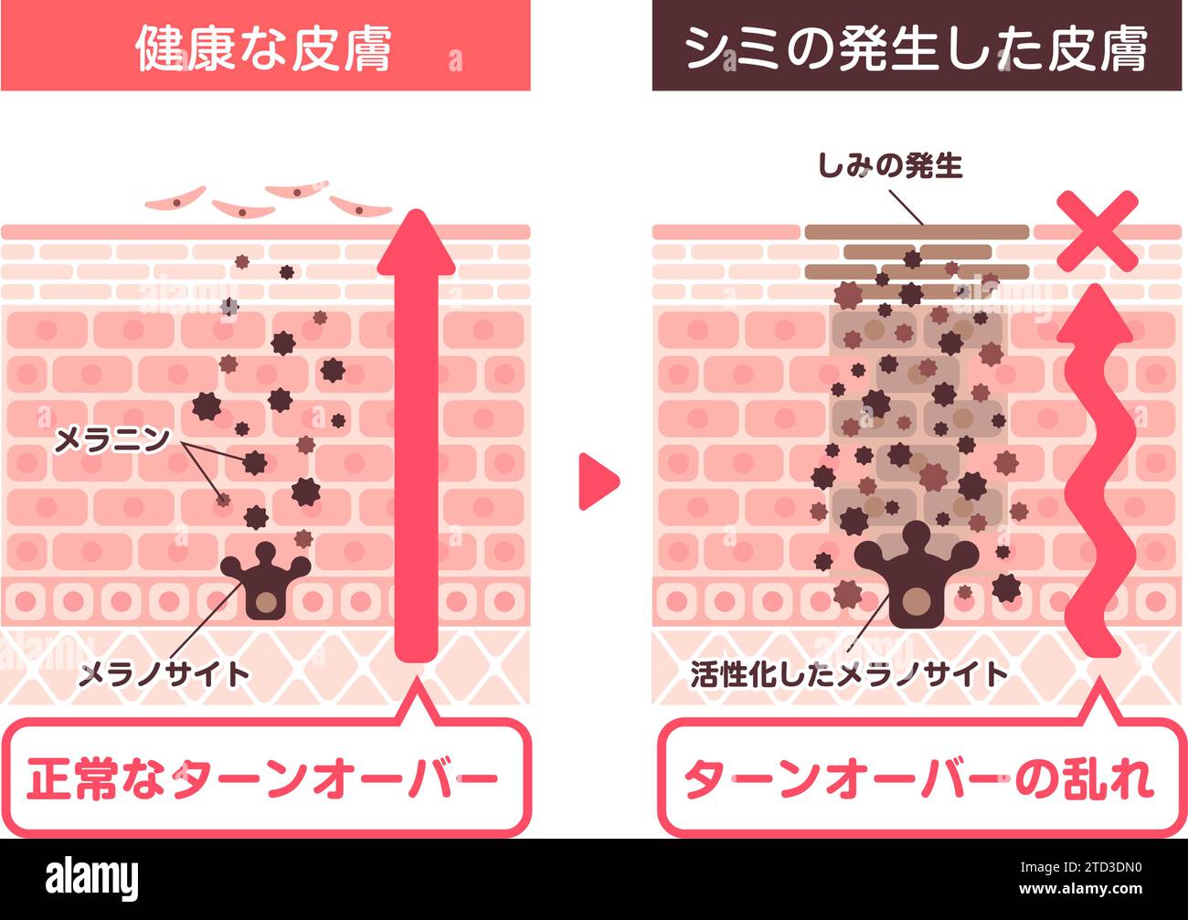 Vector illustration of how skin spots (hyperpigmentation) are created ...