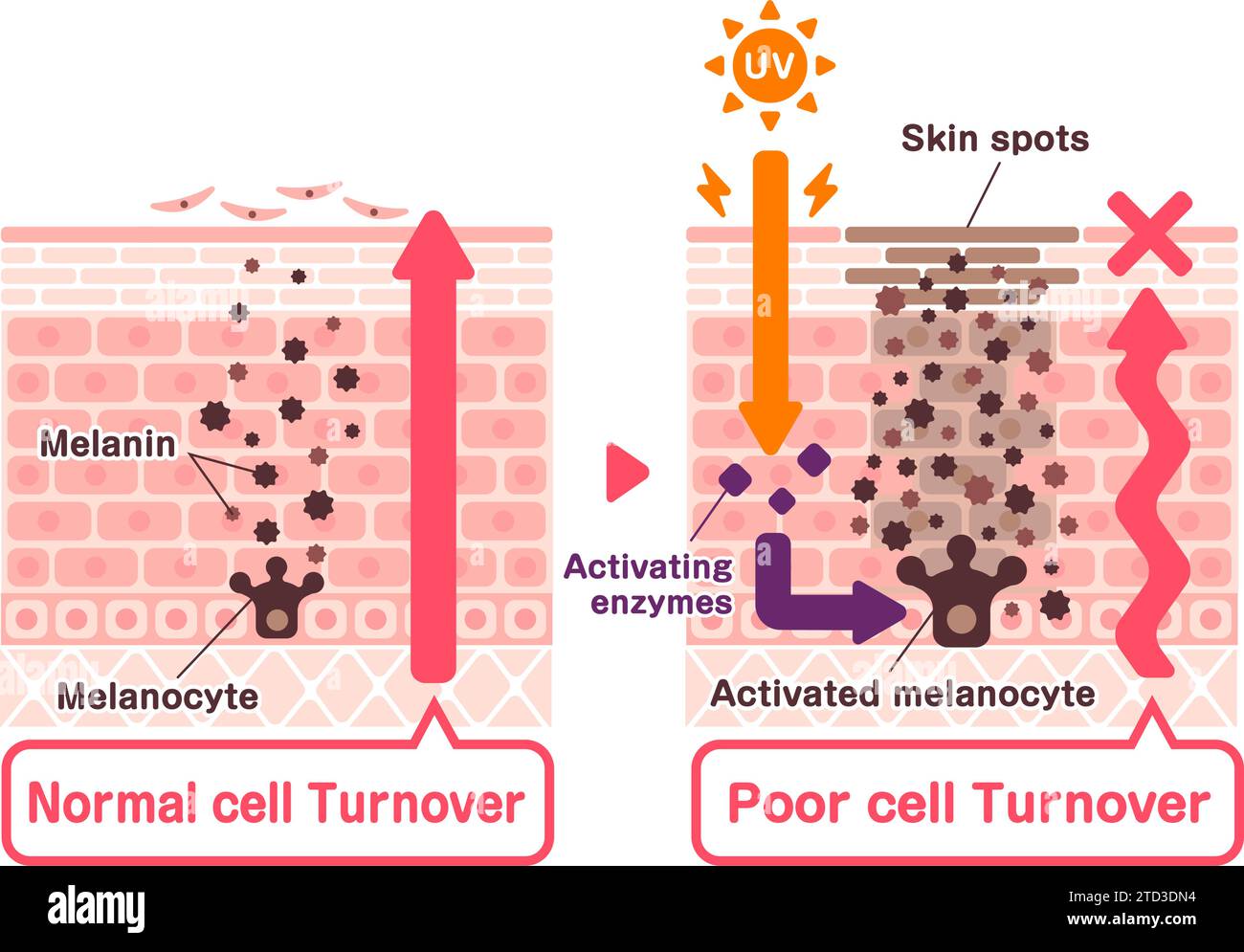 Hyperpigmentation hi-res stock photography and images - Alamy