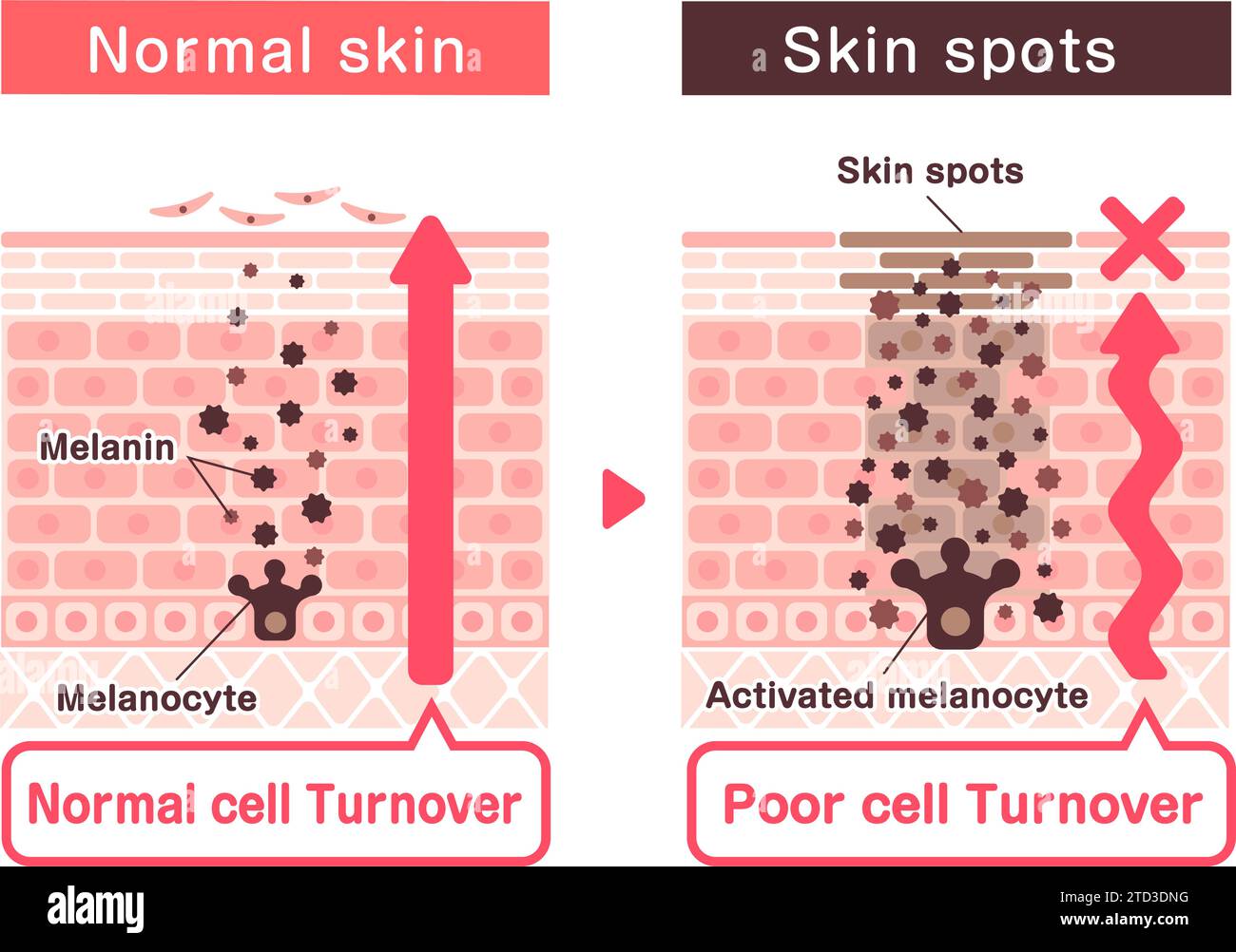 Vector illustration of how skin spots (hyperpigmentation) are created ...
