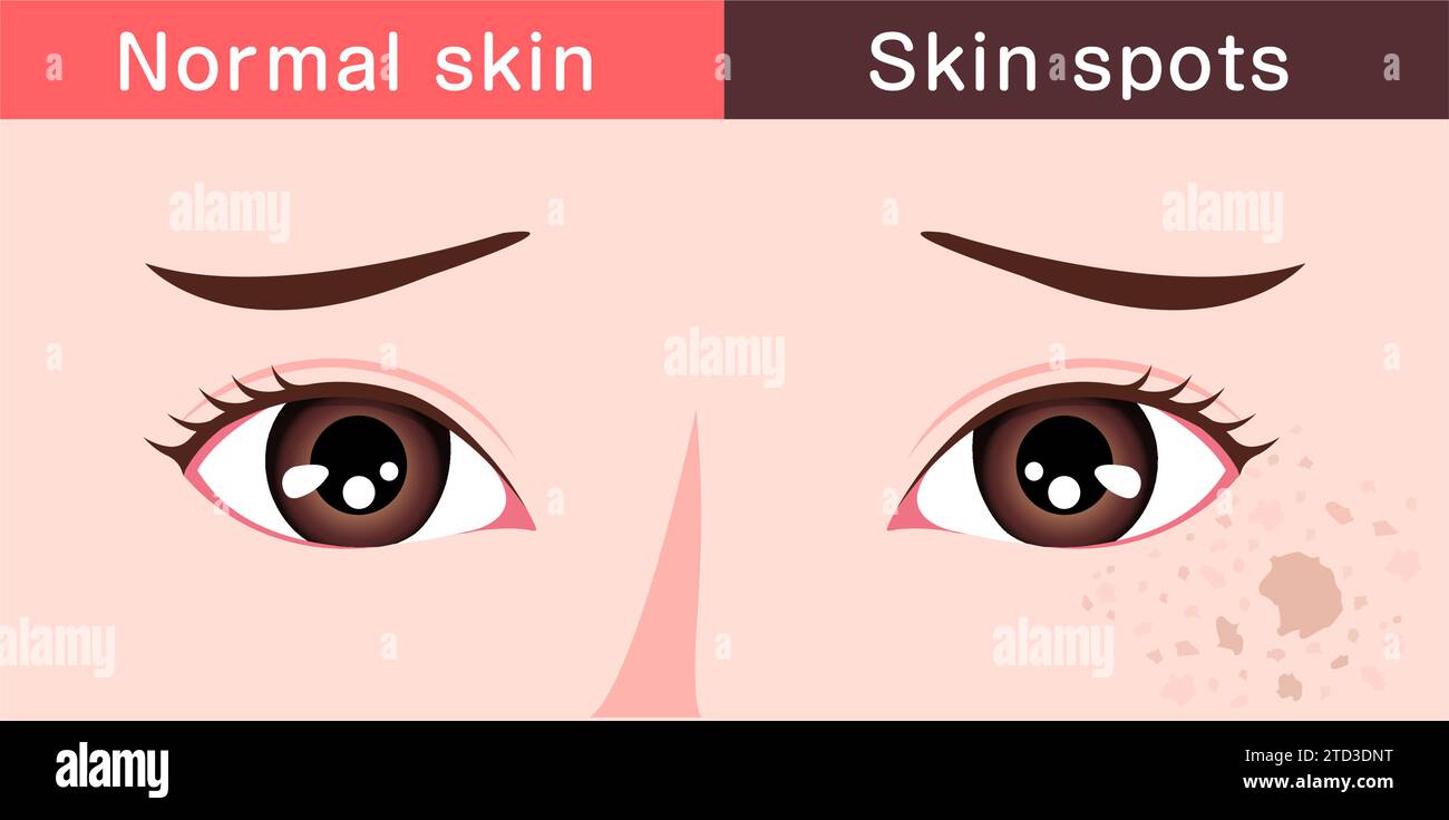 Pigmentation spots Stock Vector Images - Alamy