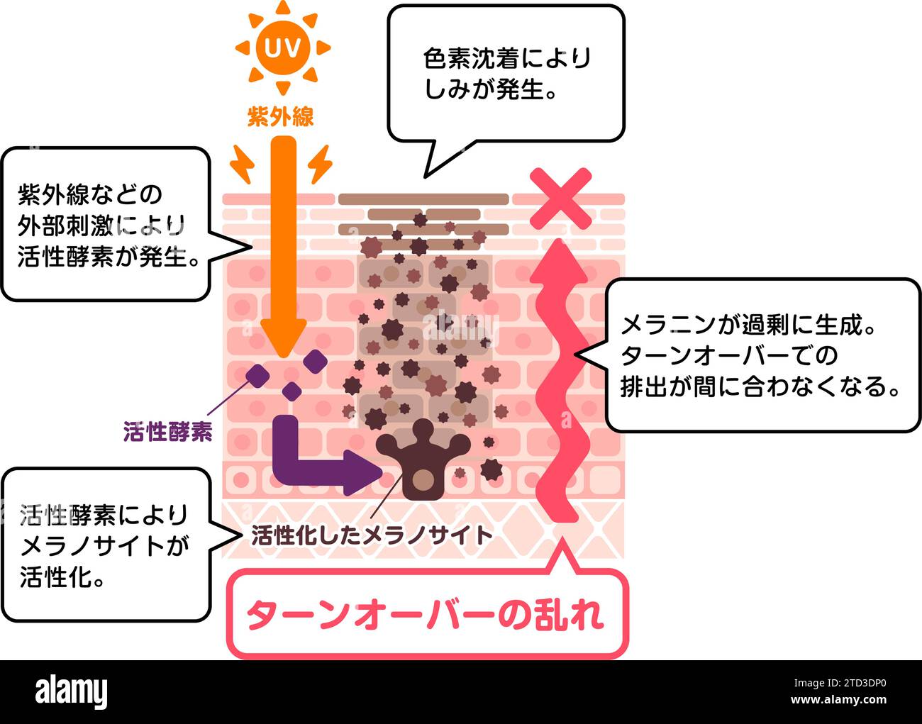 Vector illustration of how skin spots (hyperpigmentation) are created ...