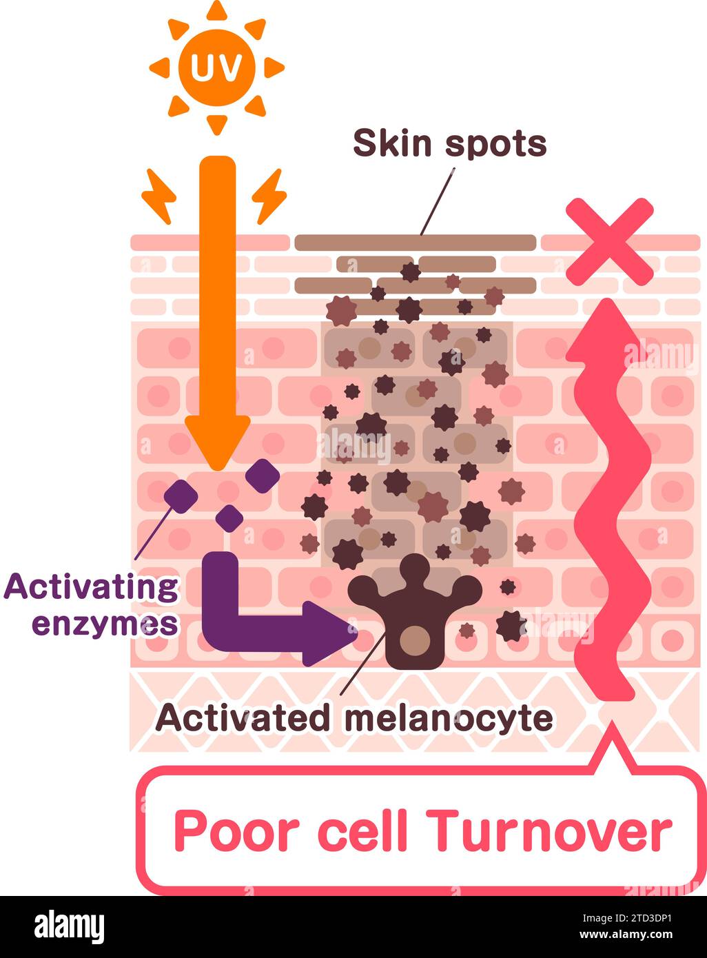 Vector illustration of how skin spots (hyperpigmentation) are created ...