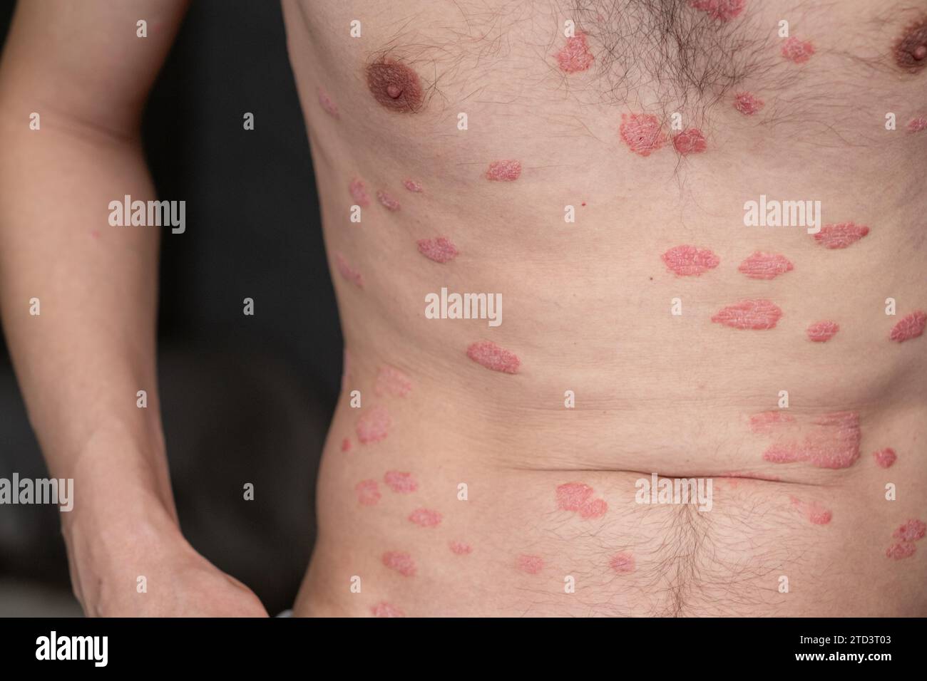 Psoriasis red itchy scaly patches hi-res stock photography and images ...