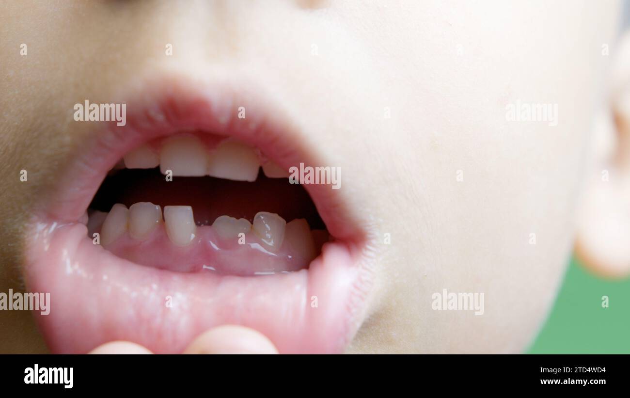 Close up, boy opens his mouth and shows his milky teeth. One missing ...