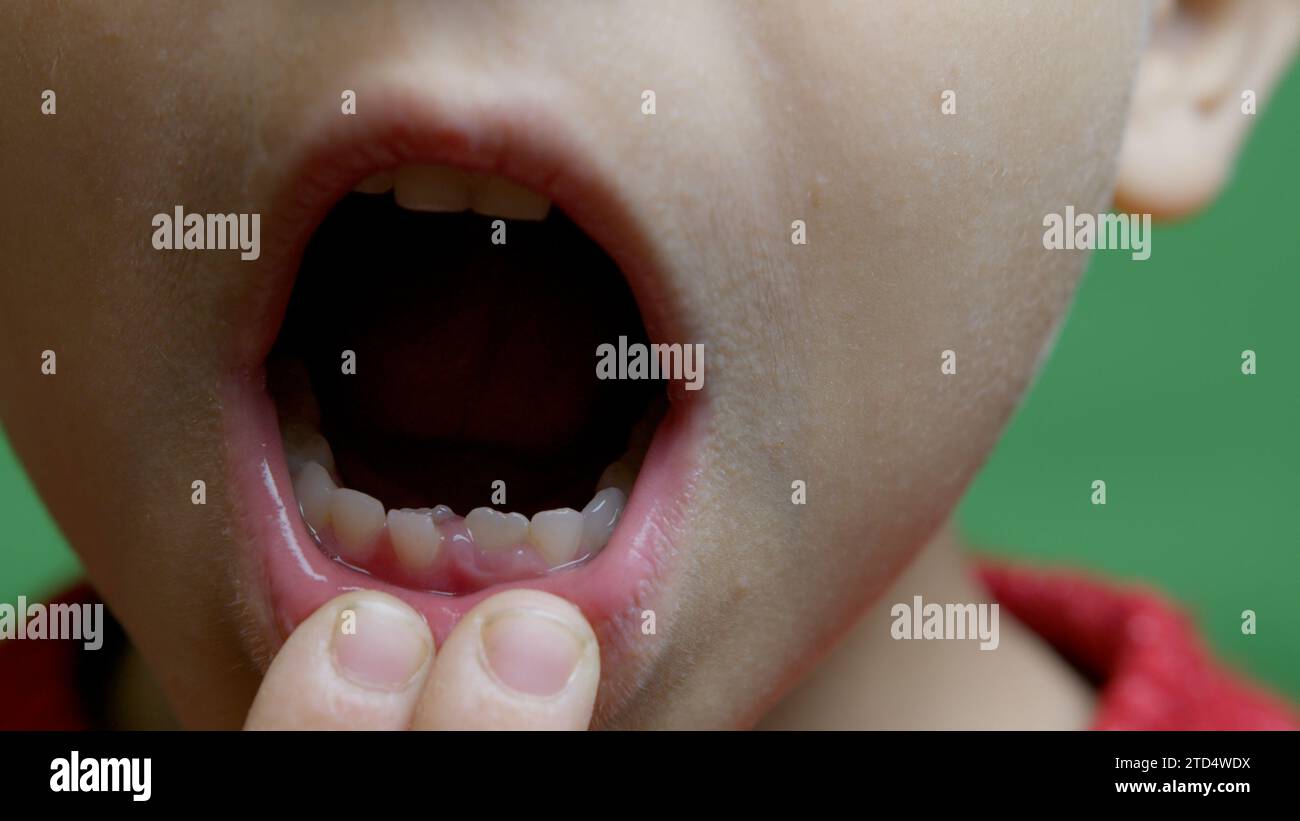 Close up, boy opens his mouth and shows his milky teeth. One missing ...