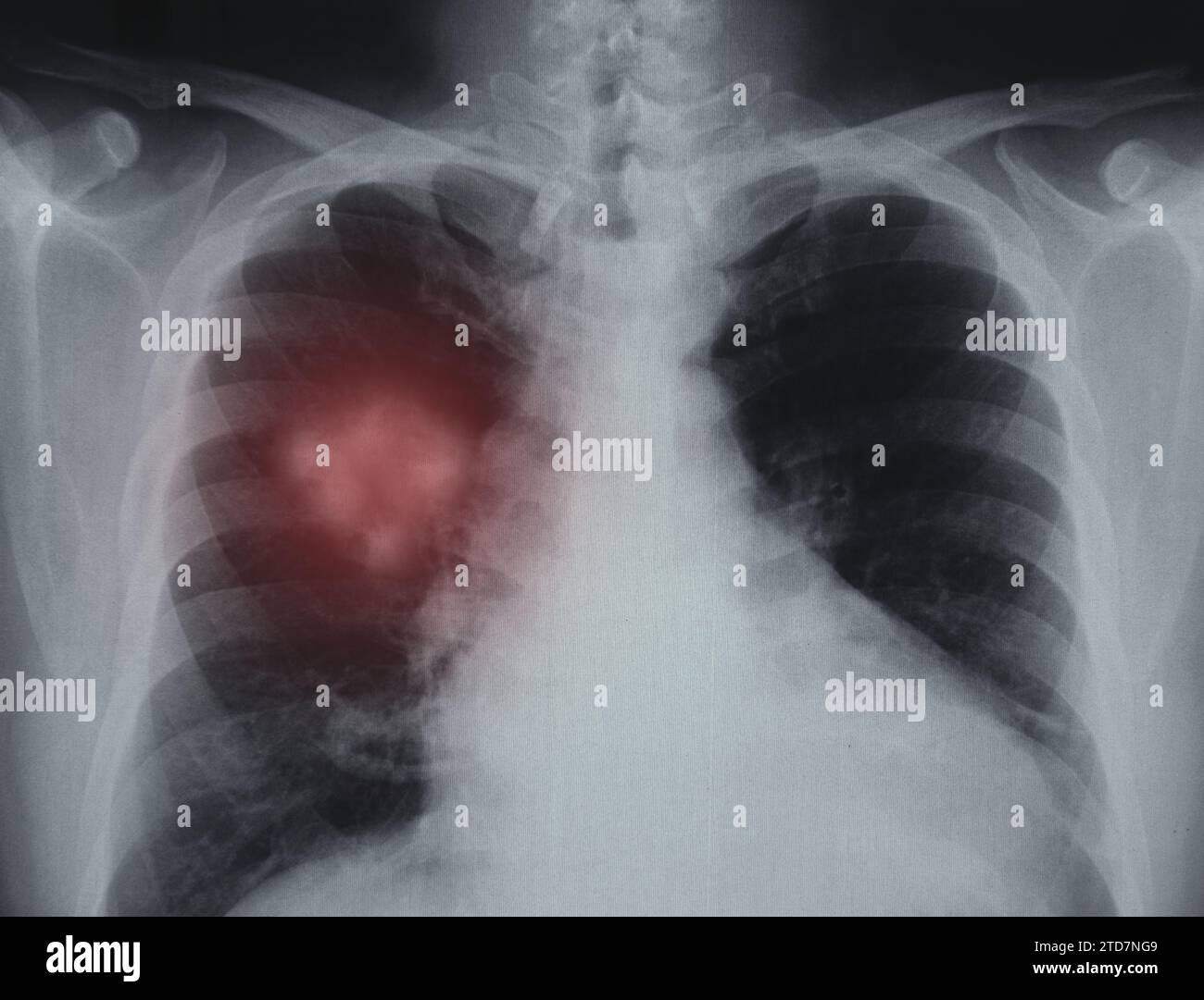 Lung cancer x ray hi-res stock photography and images - Alamy