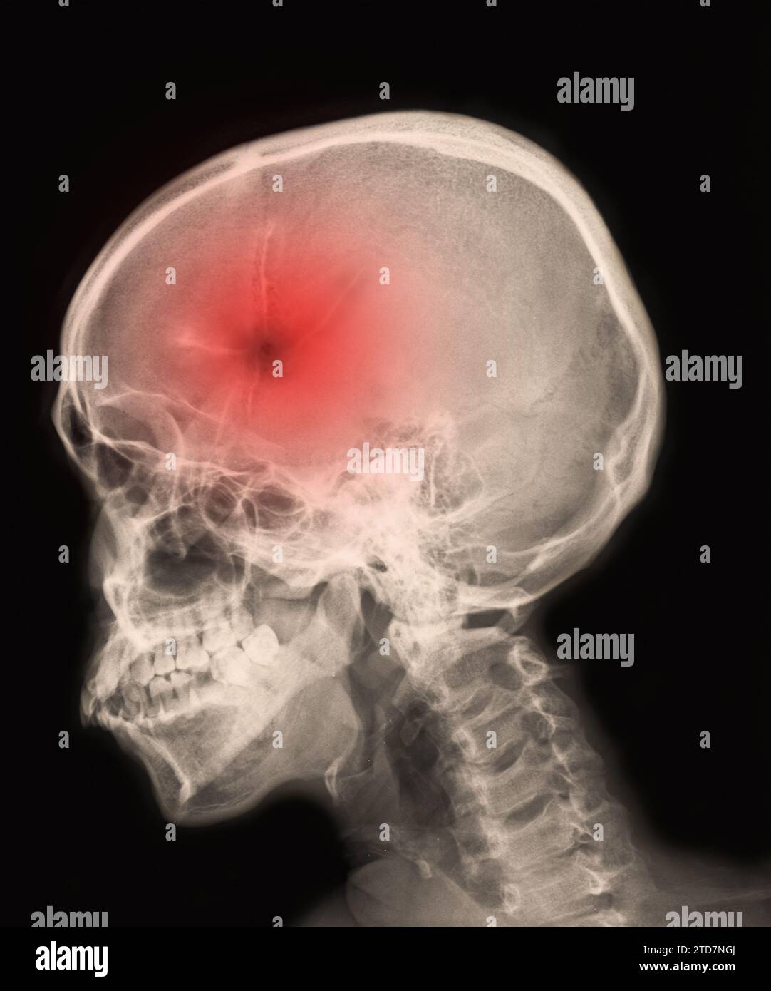 Brain hemorrhage anatomy hi-res stock photography and images - Alamy