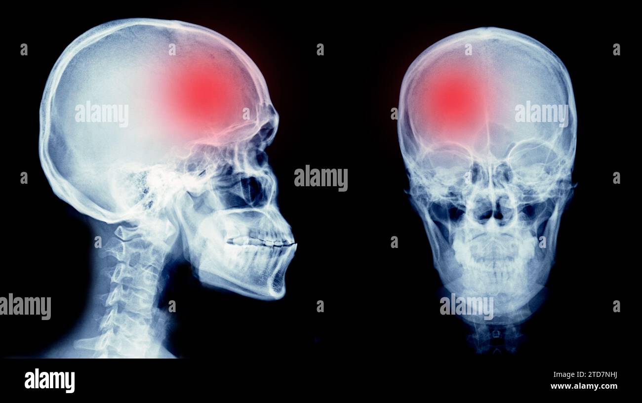 film x-ray skull of human with cerebrovascular accident area or ...