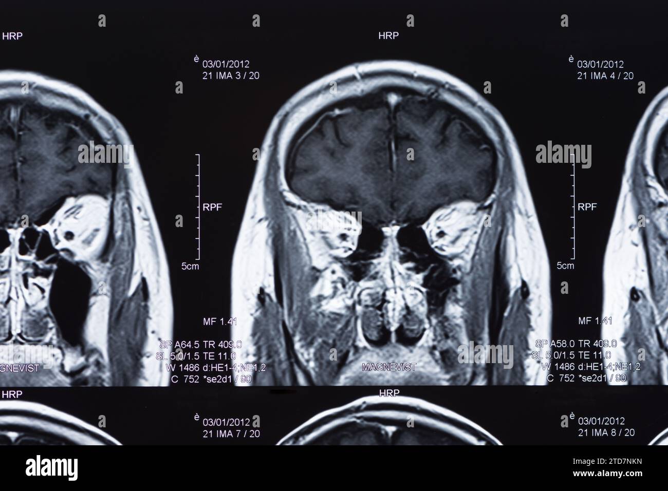 magnetic resonance image, mri scan of the brain Stock Photo - Alamy