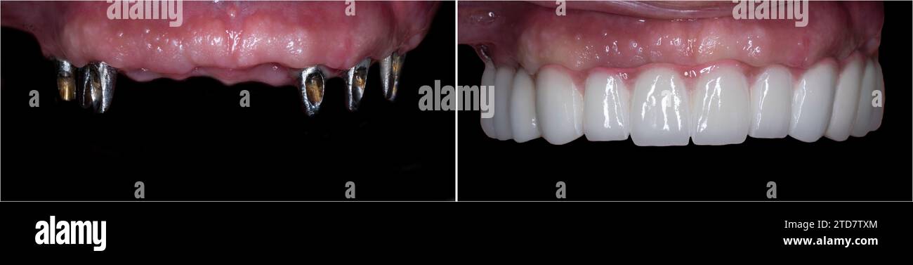 before and after picture of dental ceramic restoration on teeth and ...